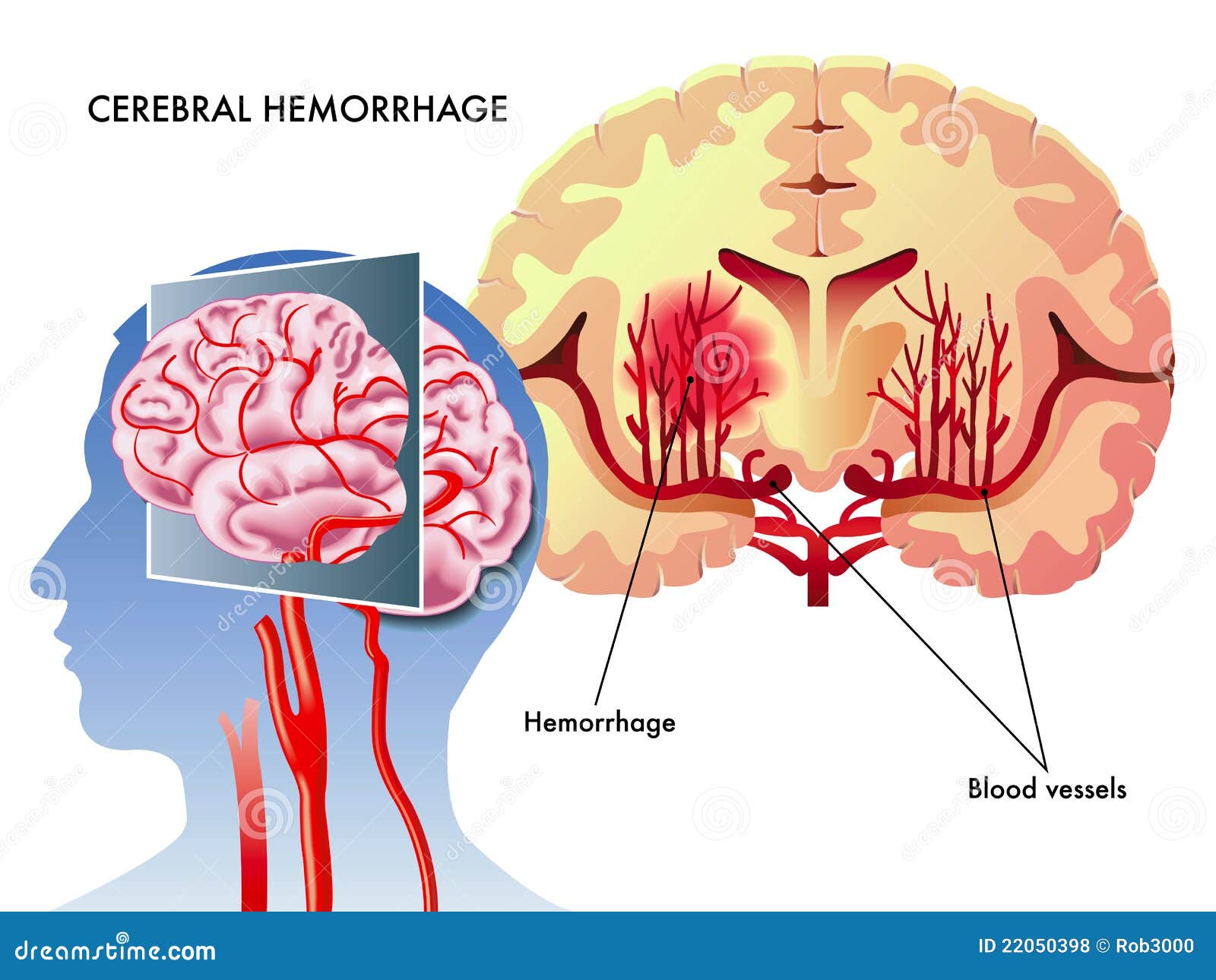 Hemorragia Cerebral Fotos de Stock Royalty Free - Imagem: 22050398