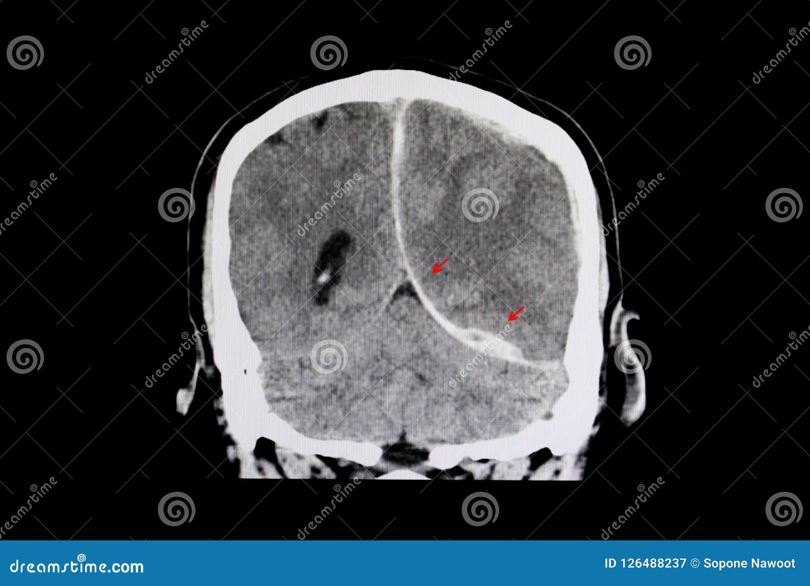 Hemorragia De Interhemispheric Imagem de Stock - Imagem de tratamento ...