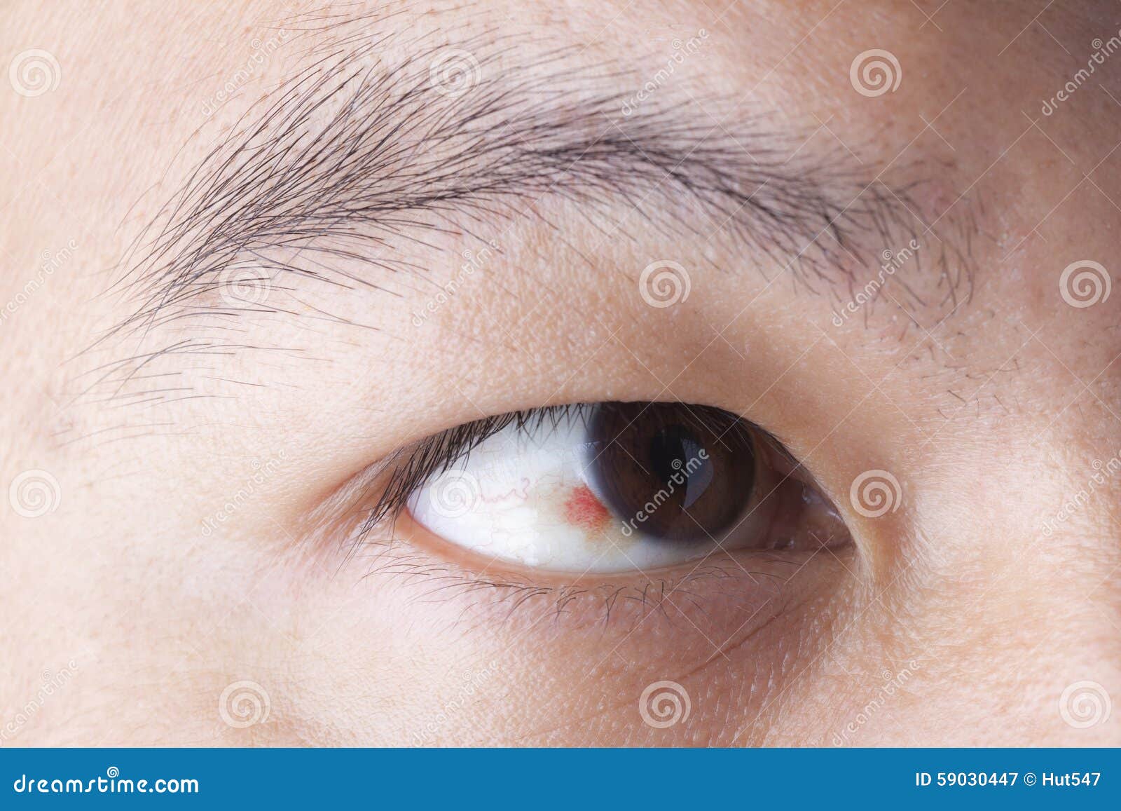 Hemorragia De Ubconjunctival En Ojo Imagen de archivo - Imagen de ...