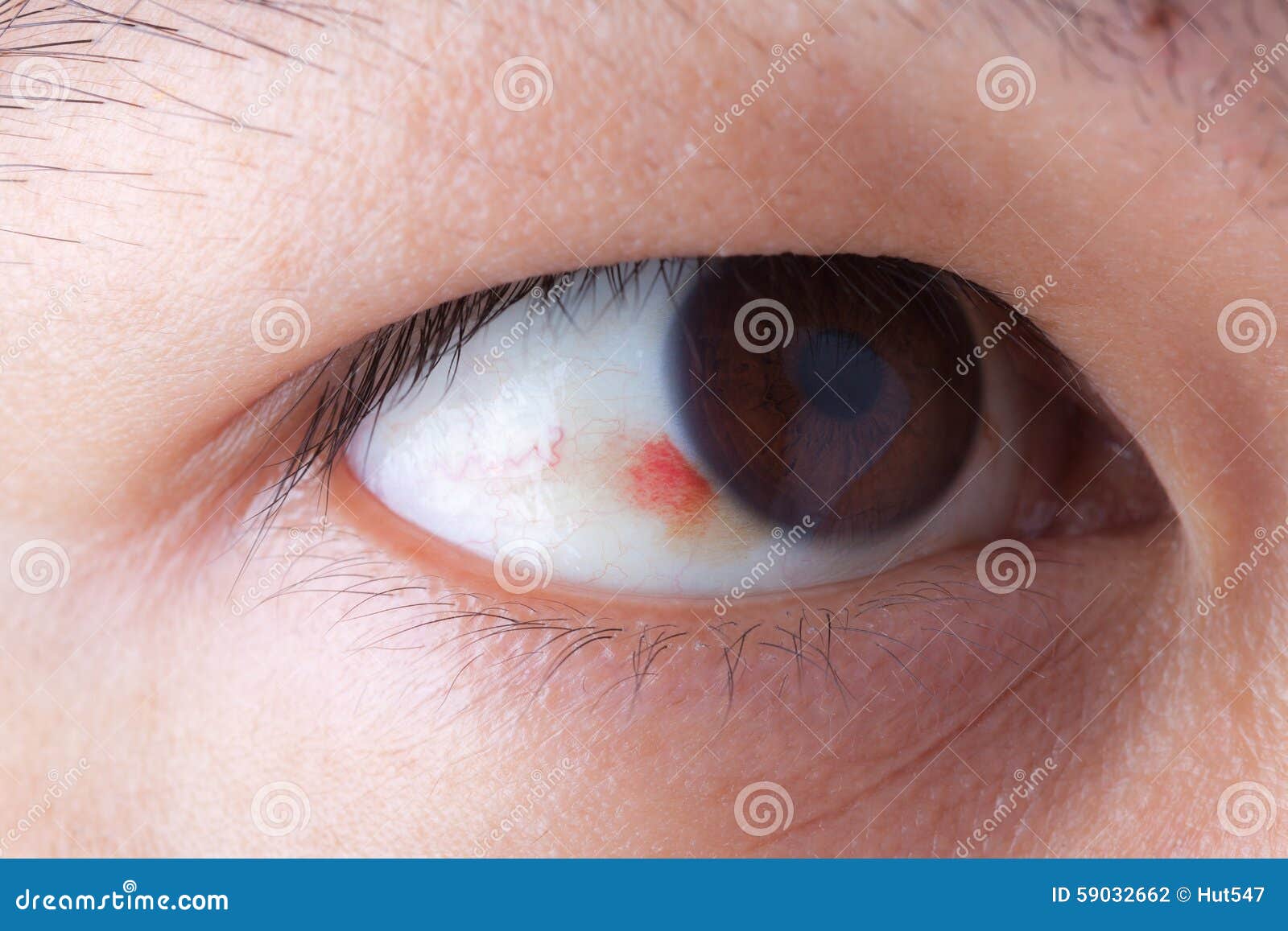 Hemorragia De Ubconjunctival En Ojo Foto de archivo - Imagen de ...