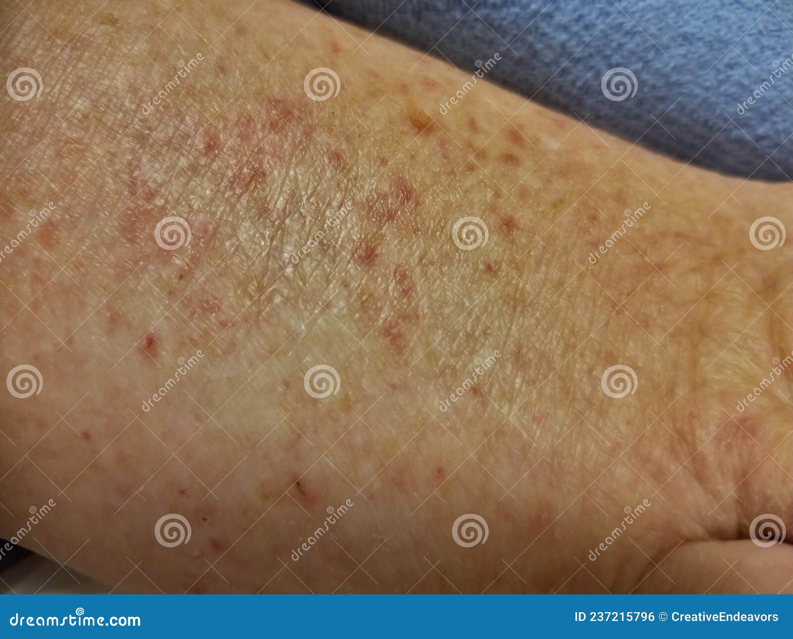 Hemorragia Espumosa Subungual Debida a Endocarditis Bacteriana Subaguda ...