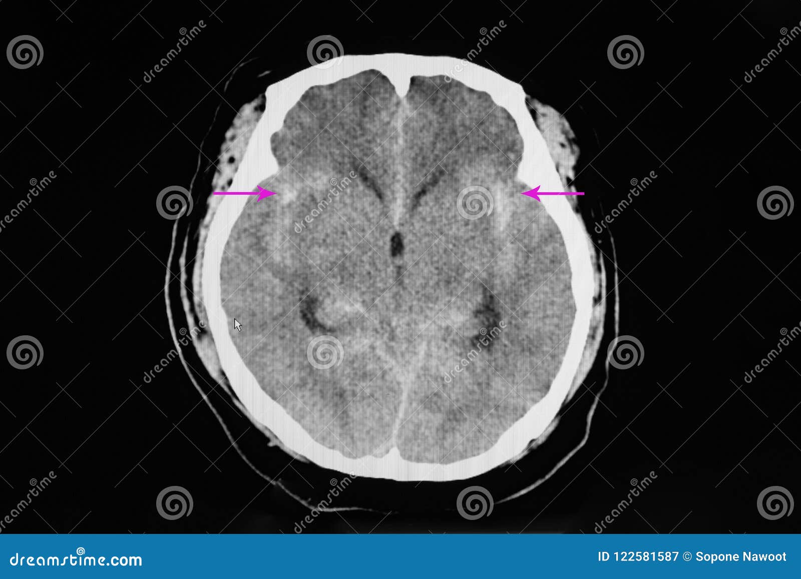Hemorragia intracerebral imagen de archivo. Imagen de fondo - 122581587
