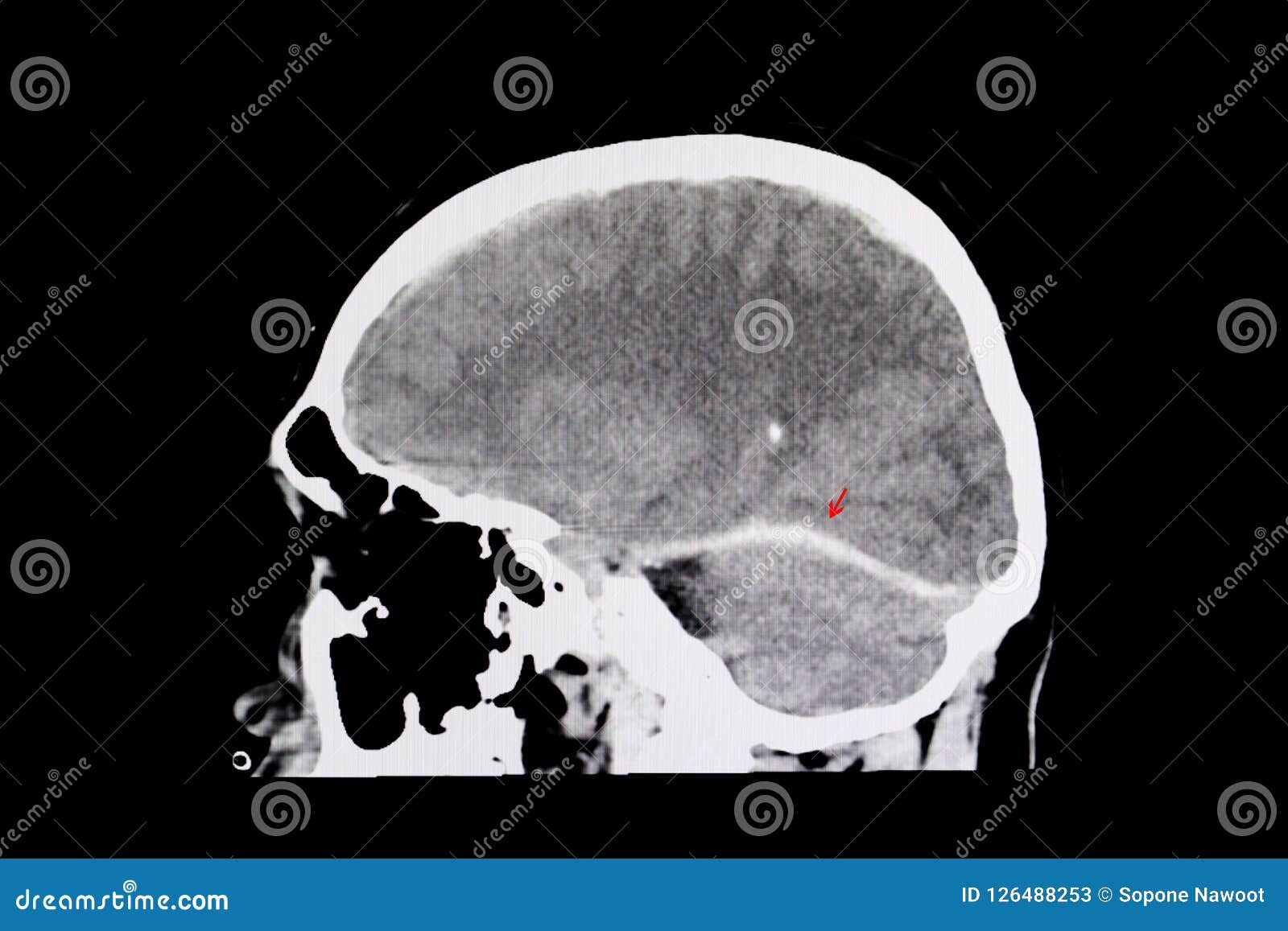 Hemorragia intracerebral imagen de archivo. Imagen de fondo - 126488253