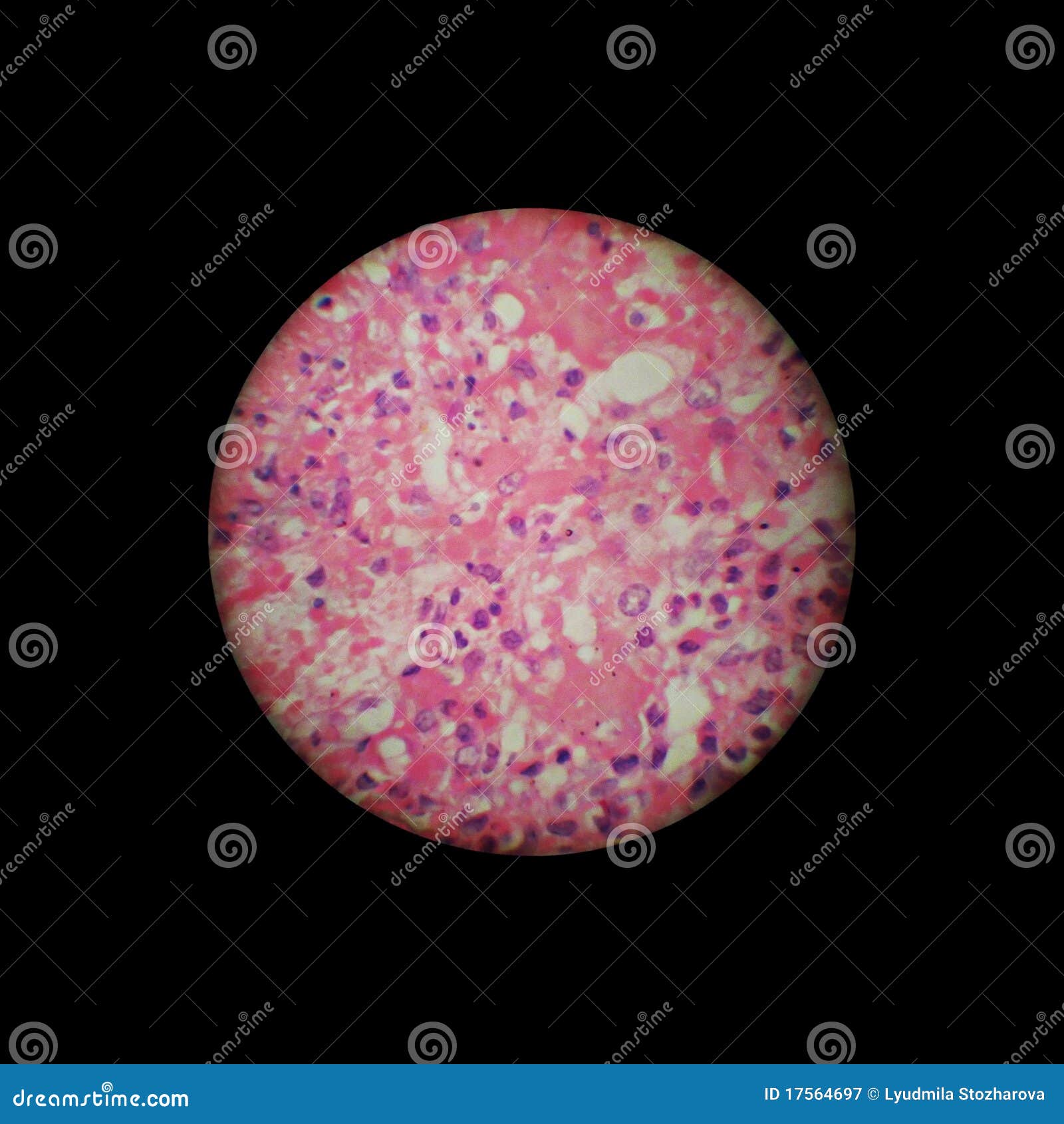 Hemorragic lung infarct stock image. Image of organic - 17564697