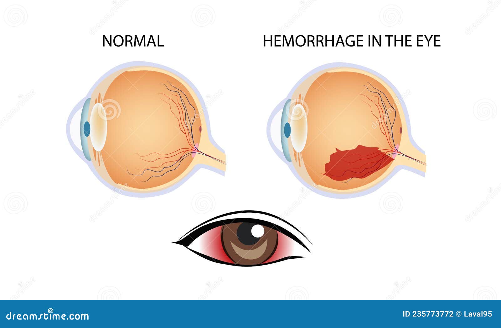 Hemorrhage in the Eye, Vector Medical Illustration Stock Vector ...
