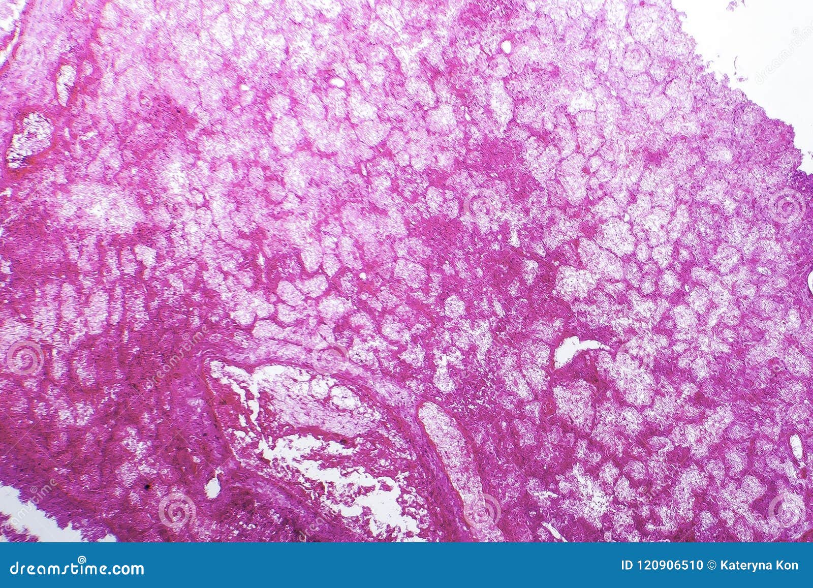 Hemorrhagic Infarct of the Lung Stock Photo - Image of microscope ...