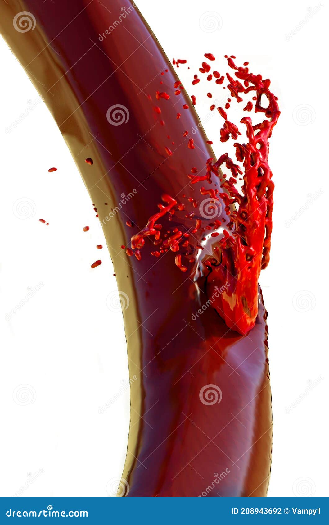 Hemorrhagic Stroke. an Artery Ruptures Causing More or less Extensive ...