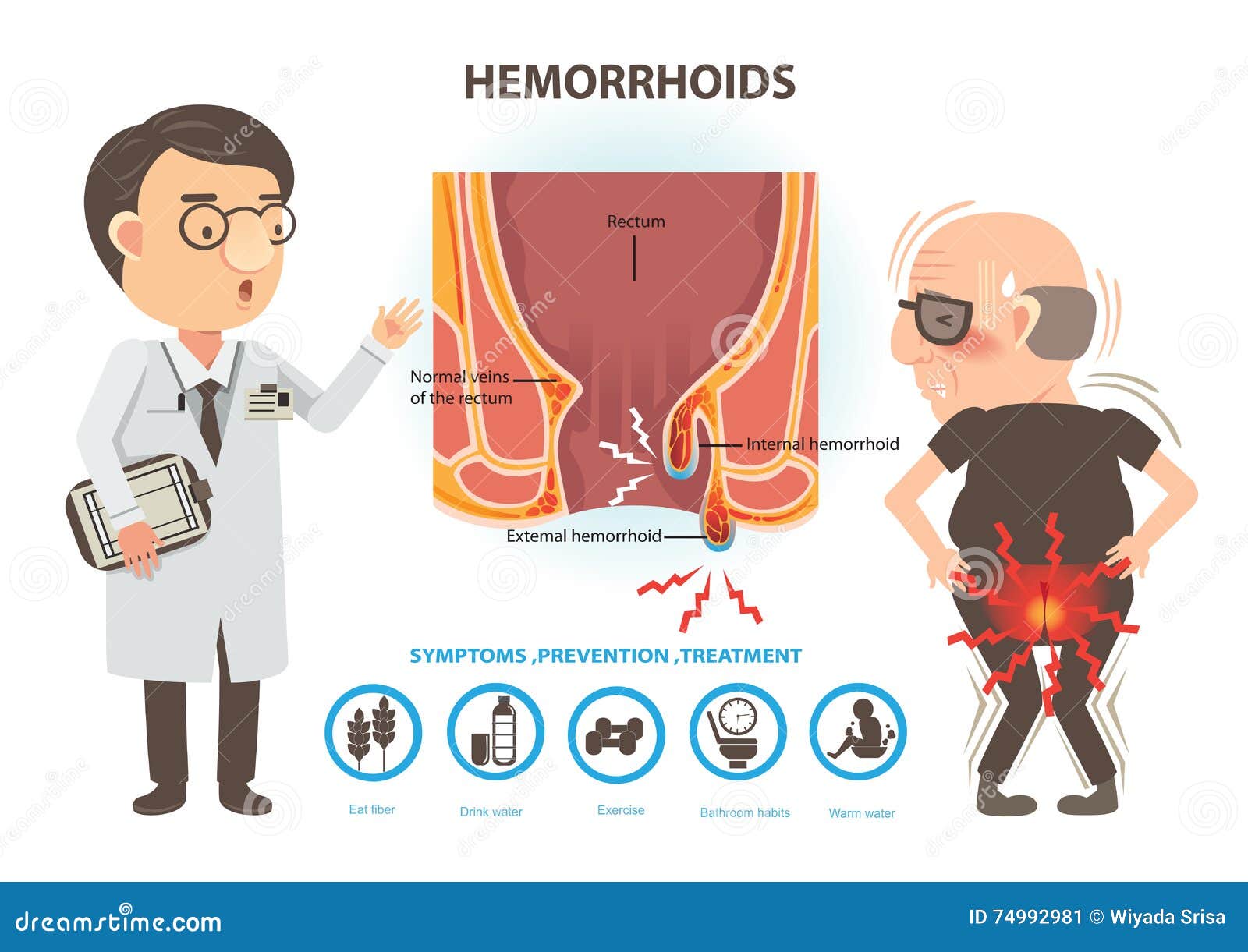 Hemorrhoids ilustração do vetor. Ilustração de cuidado - 74992981