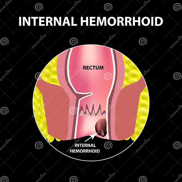 Hemorrhoids Internal Rectum Structure Intestines Colon Internal