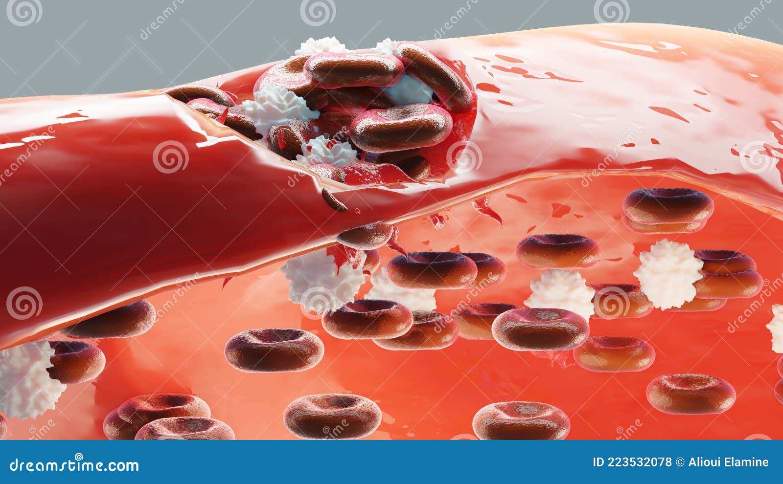 Hemostasis. Red Blood Cells and Platelets in the Blood Vessel. Basic ...
