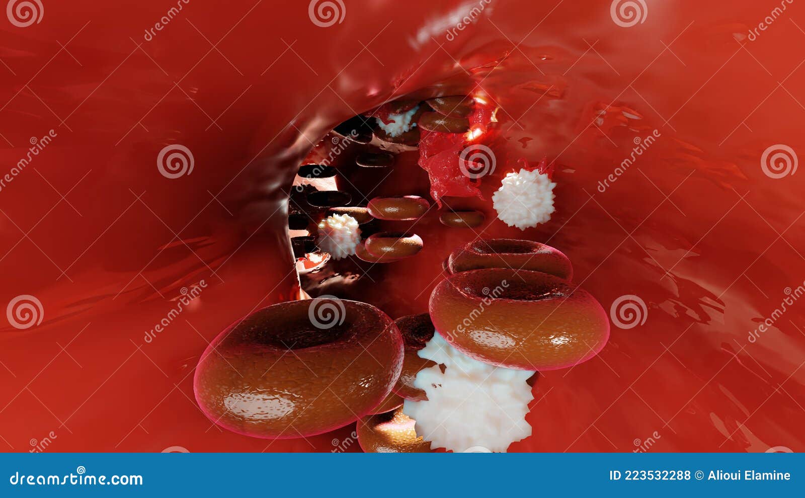 Hemostasis. Red Blood Cells and Platelets in the Blood Vessel Stock ...