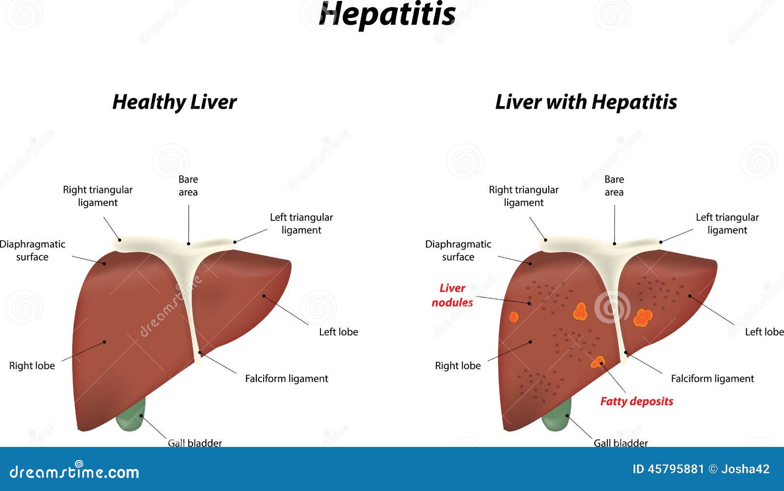 Hepatit vektor illustrationer. Illustration av hepatisk - 45795881