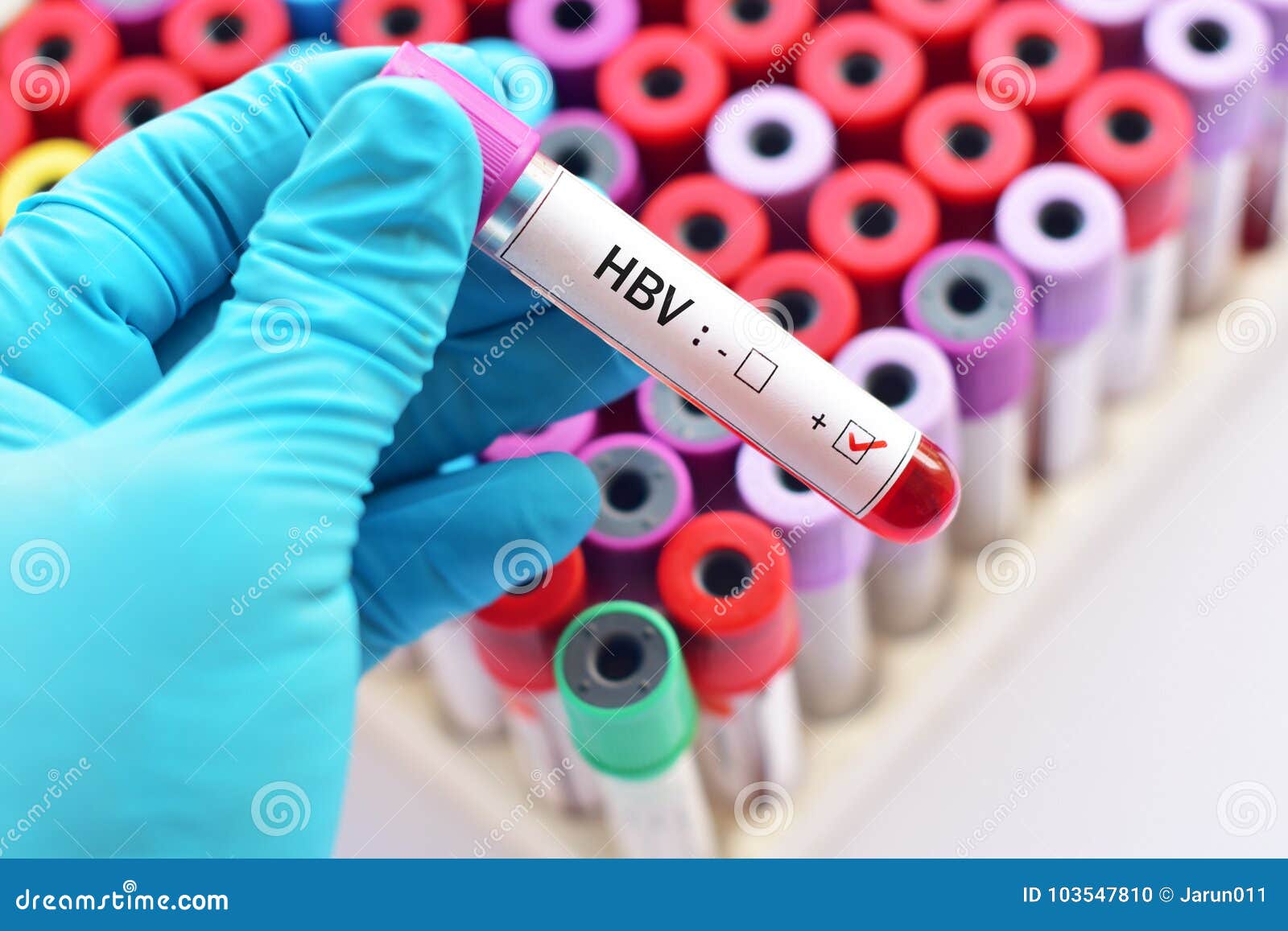 Hepatitis B virus positive stock photo. Image of hospital - 103547810
