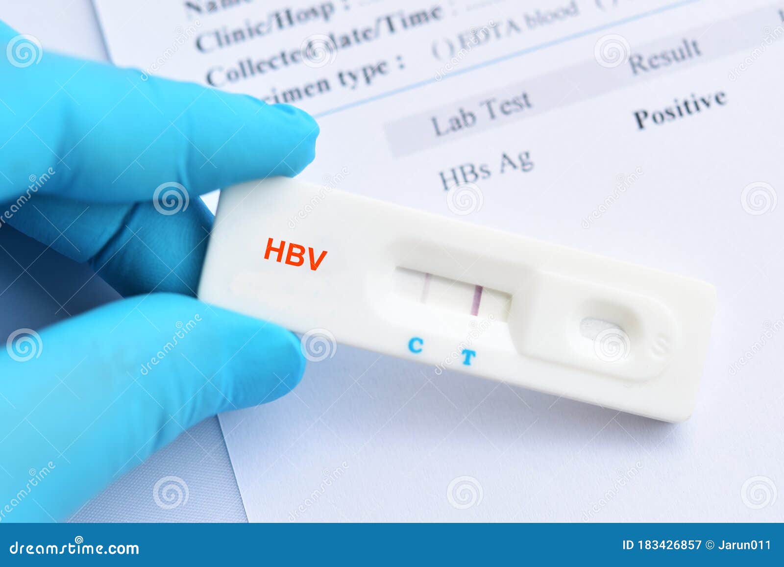 Hepatitis B Virus Positive Test Result Stock Image - Image of patient ...