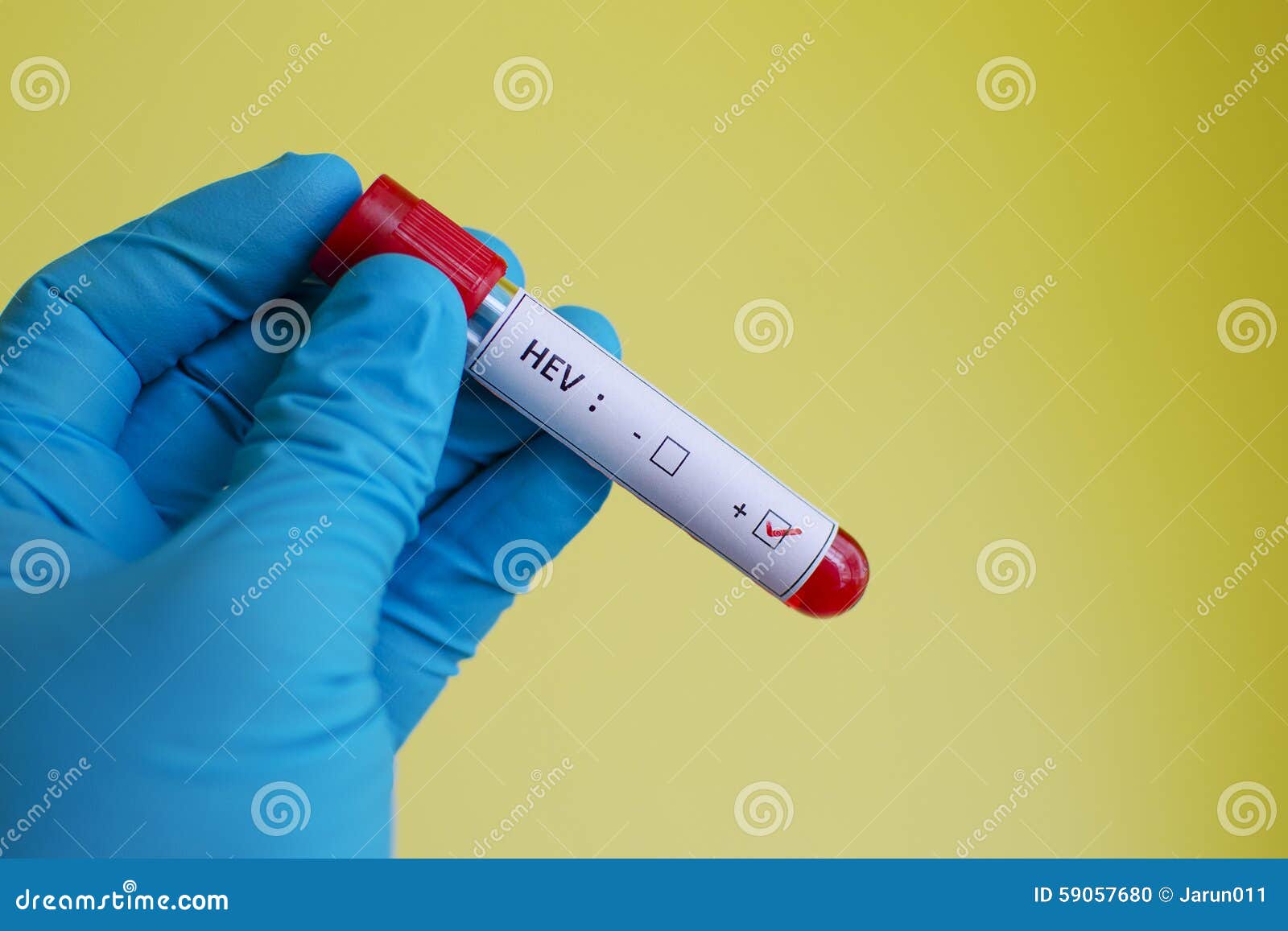 Hepatitis E Virus (HEV) Positive Stock Photo - Image of scientific ...