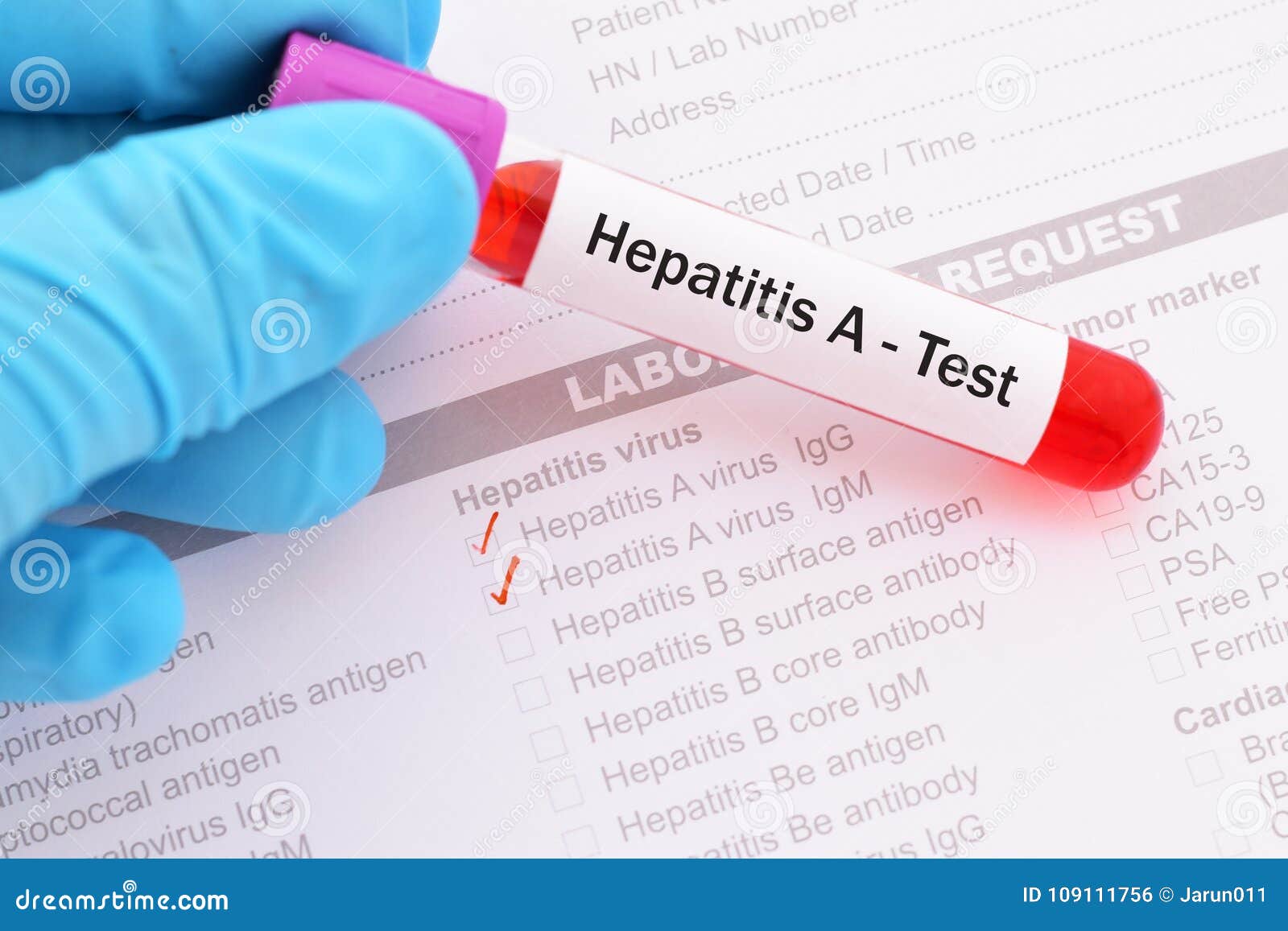 Hepatitis a virus test stock photo. Image of illness - 109111756