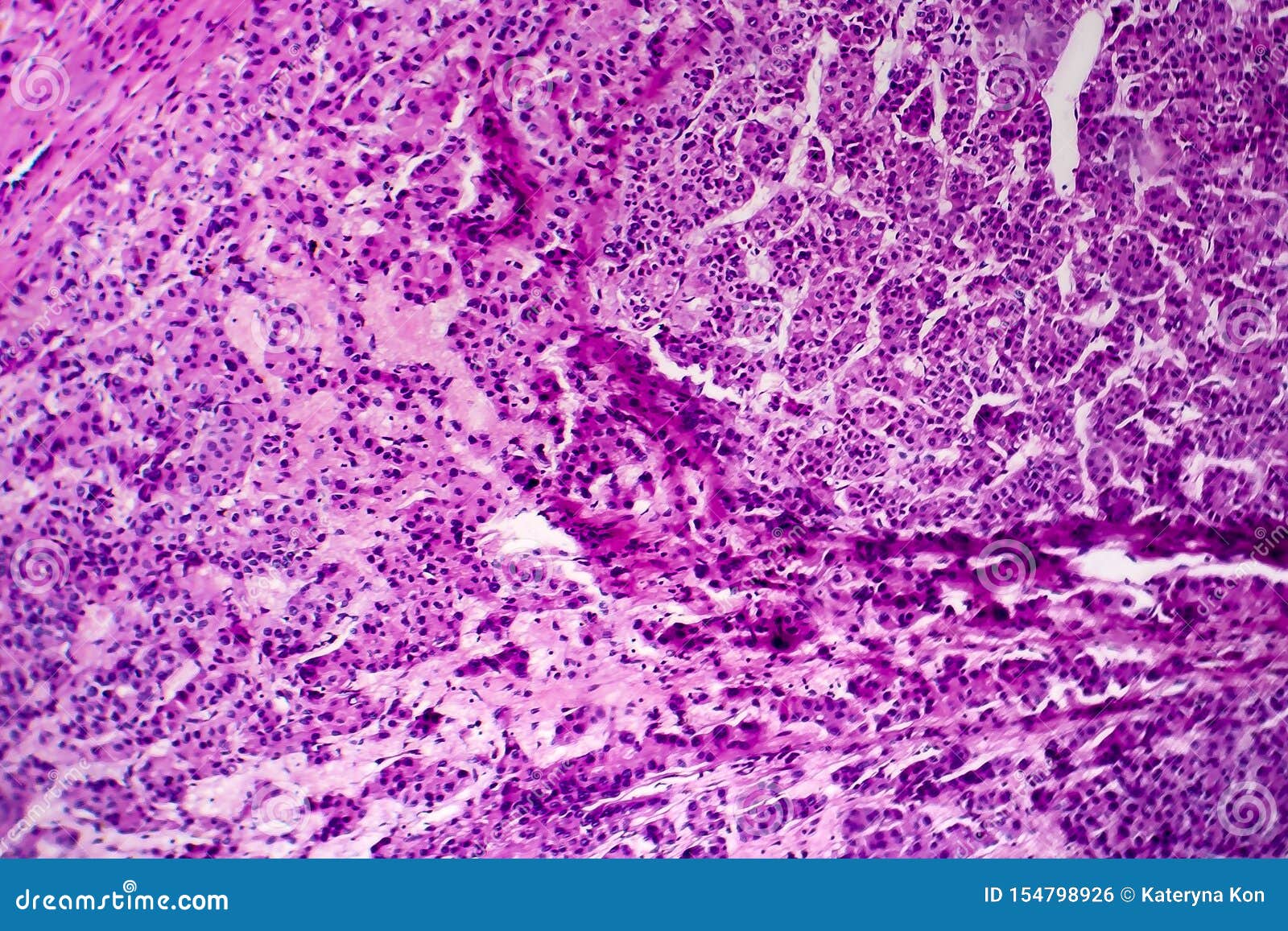 Hepatocellular Carcinoma, Light Micrograph Stock Photo - Image of ...