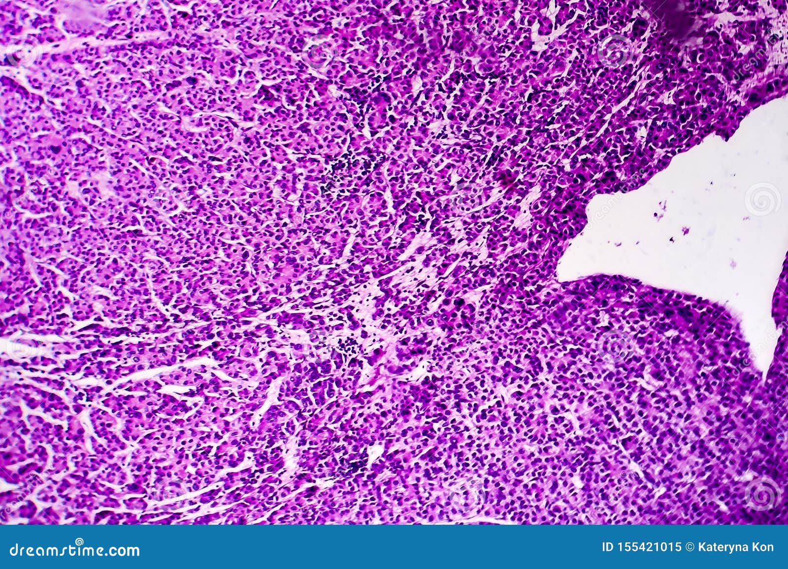 Hepatocellular Carcinoma, Light Micrograph Stock Image - Image of stain ...