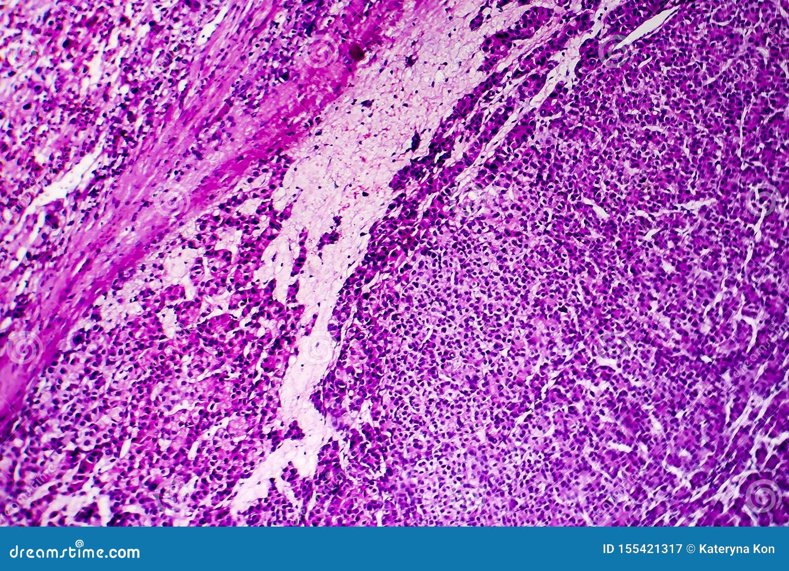Hepatocellular Carcinoma, Light Micrograph Stock Image - Image of ...