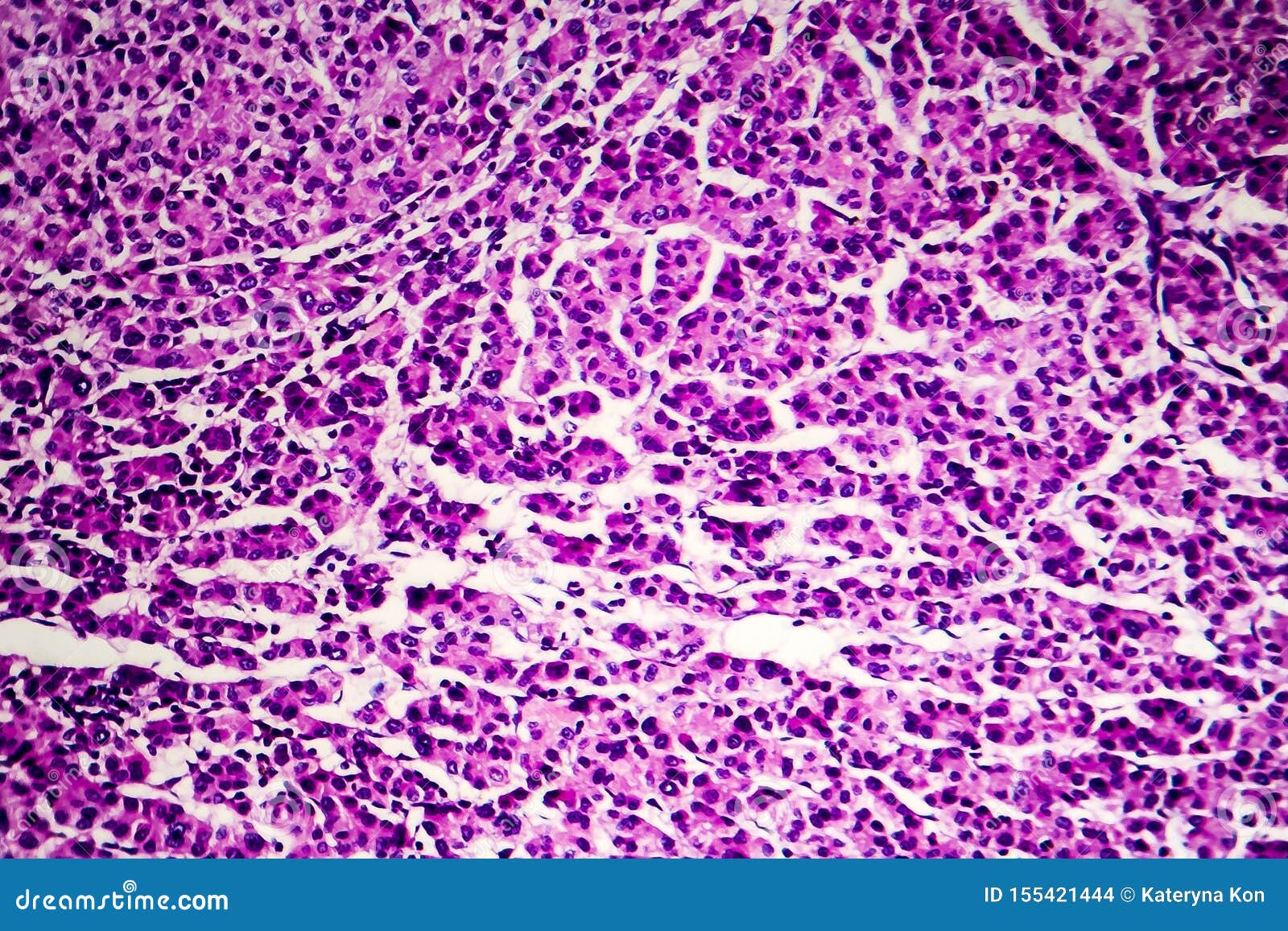 Hepatocellular Carcinoma, Light Micrograph Stock Photo - Image of micro ...