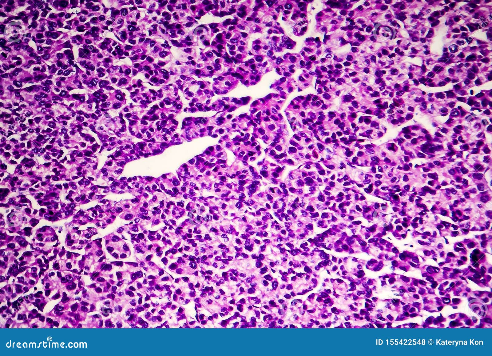 Hepatocellular Carcinoma, Light Micrograph Stock Photo - Image of ...