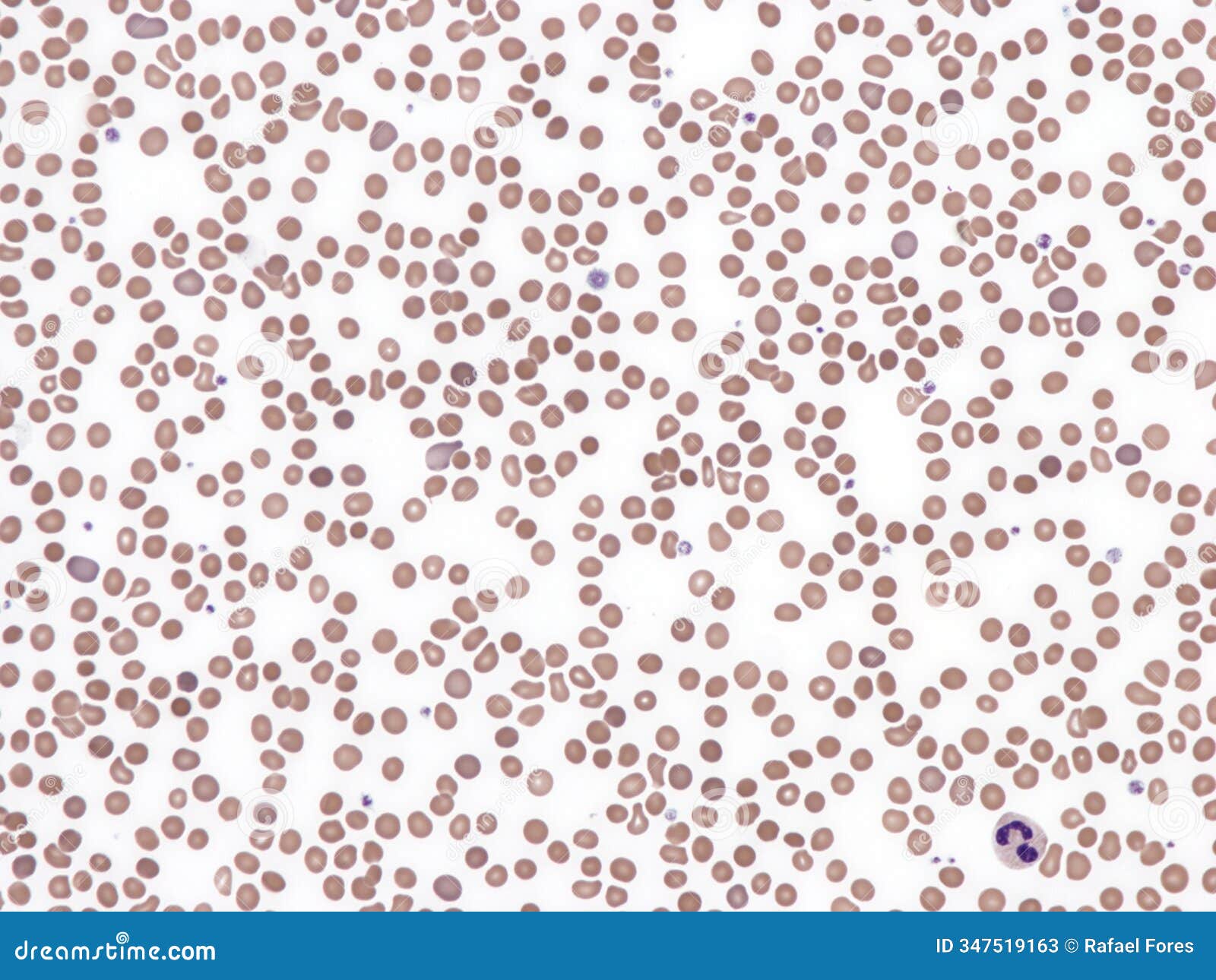 Hereditary spherocytosis. stock image. Image of medical - 347519163