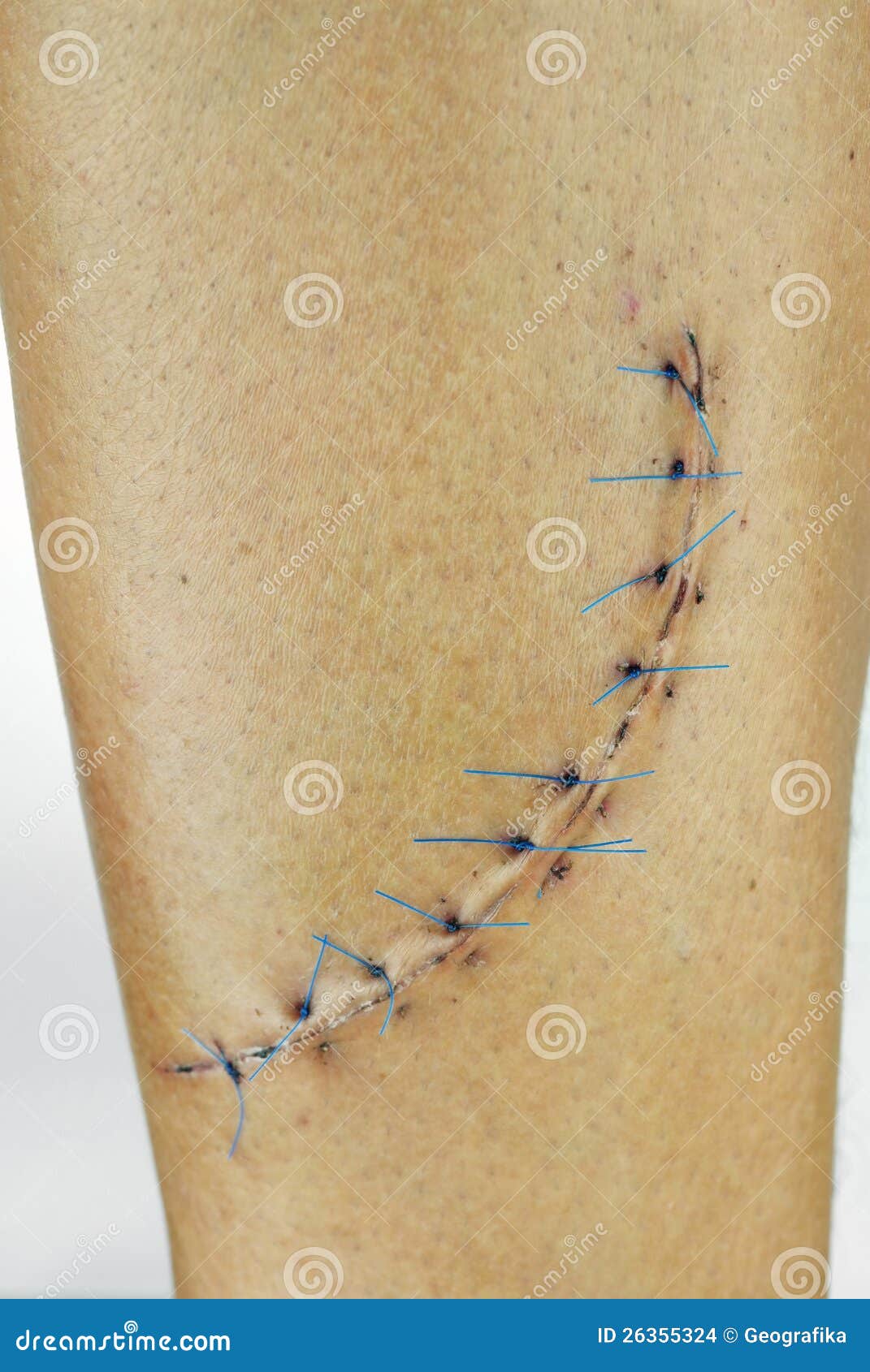Herida cosida foto de archivo. Imagen de pierna, cicatriz - 26355324