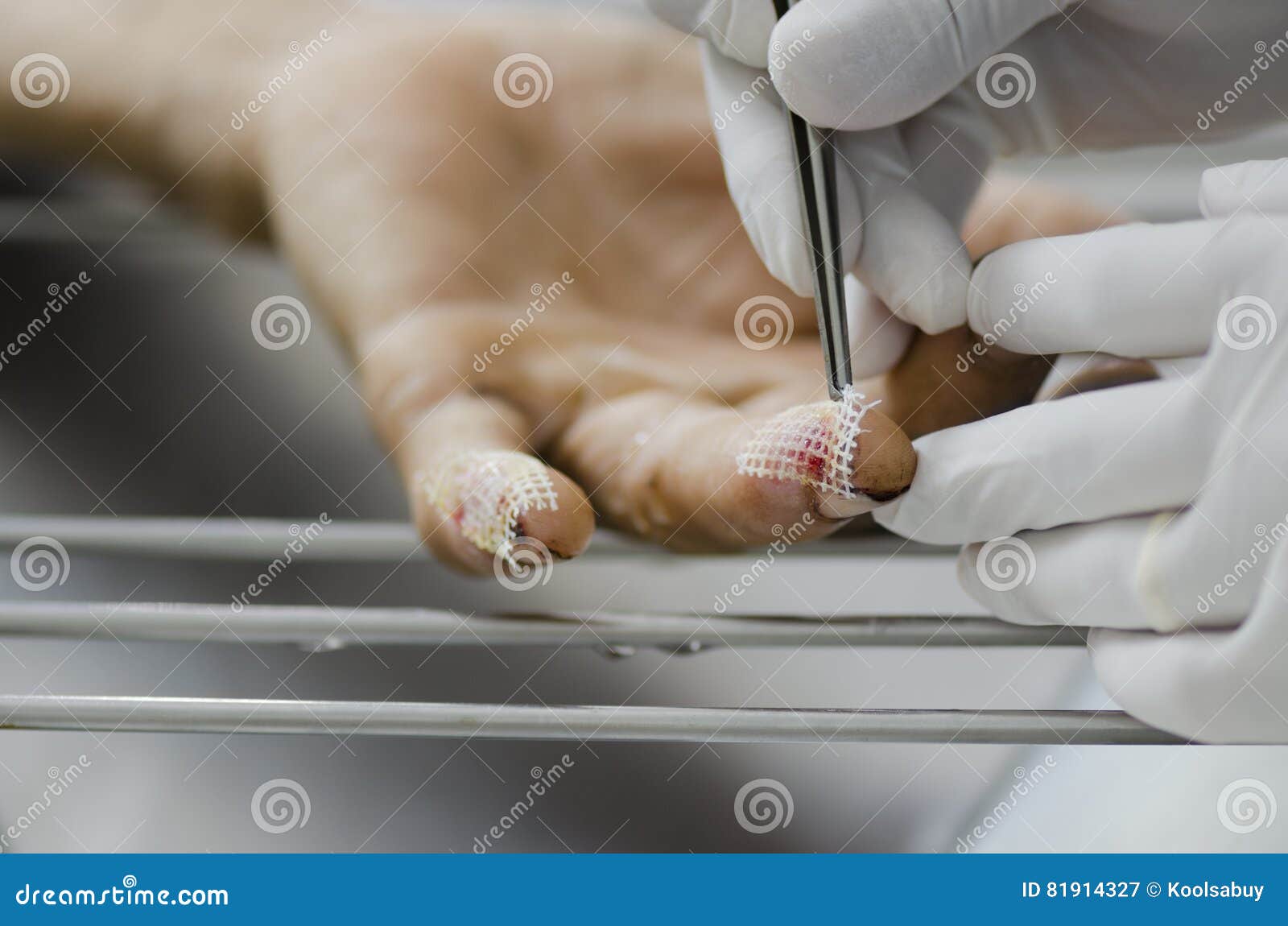 Herida De La Gasa De La Vaselina Imagen de archivo - Imagen de ...