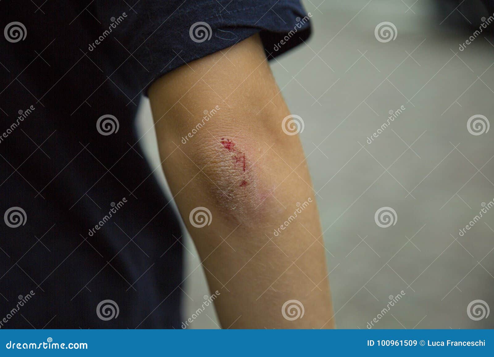 Herida en el codo imagen de archivo. Imagen de travieso - 100961509