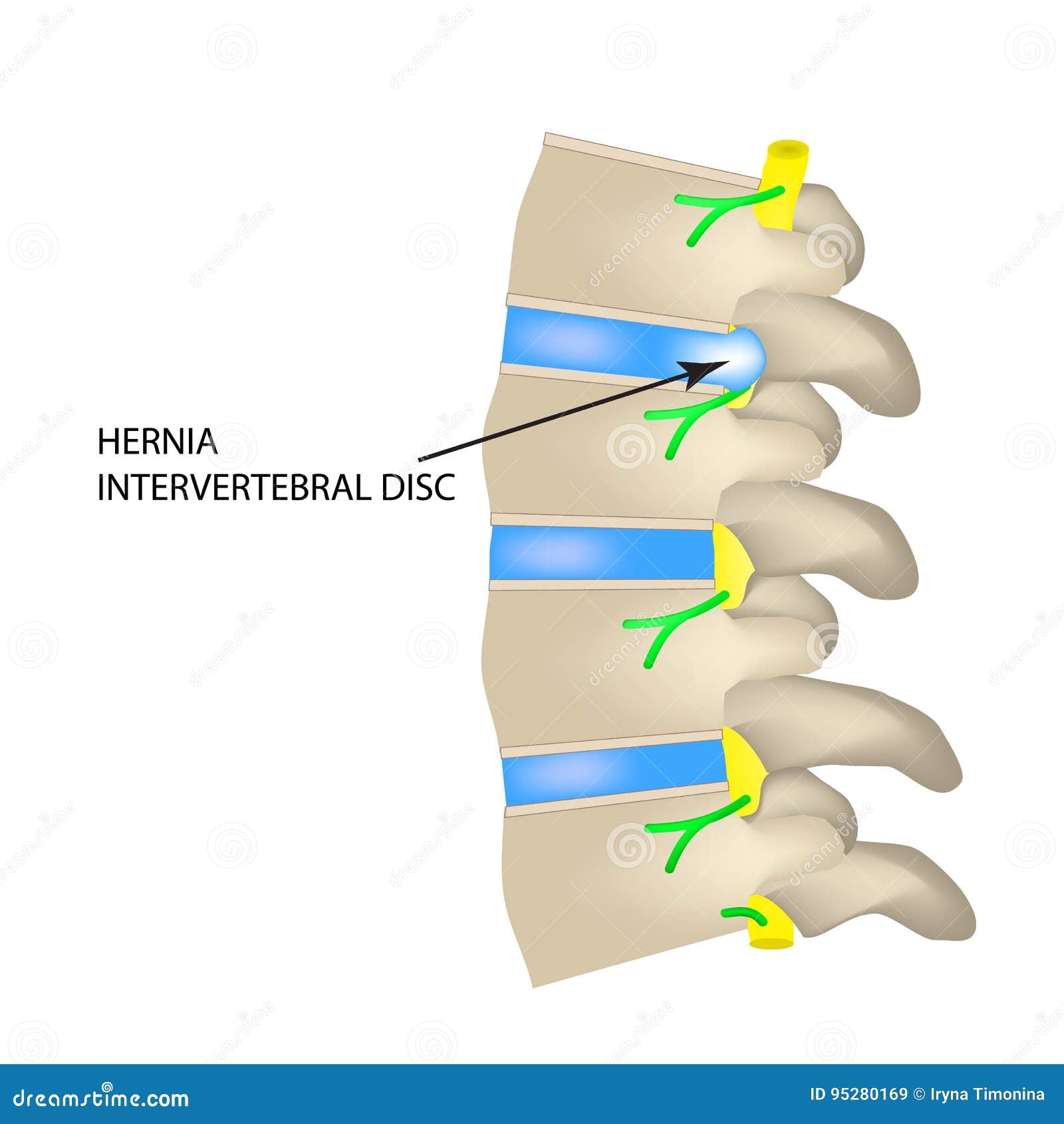 A Hernia Of The Intervertebral Disc. Vector Illustration On Isolated ...