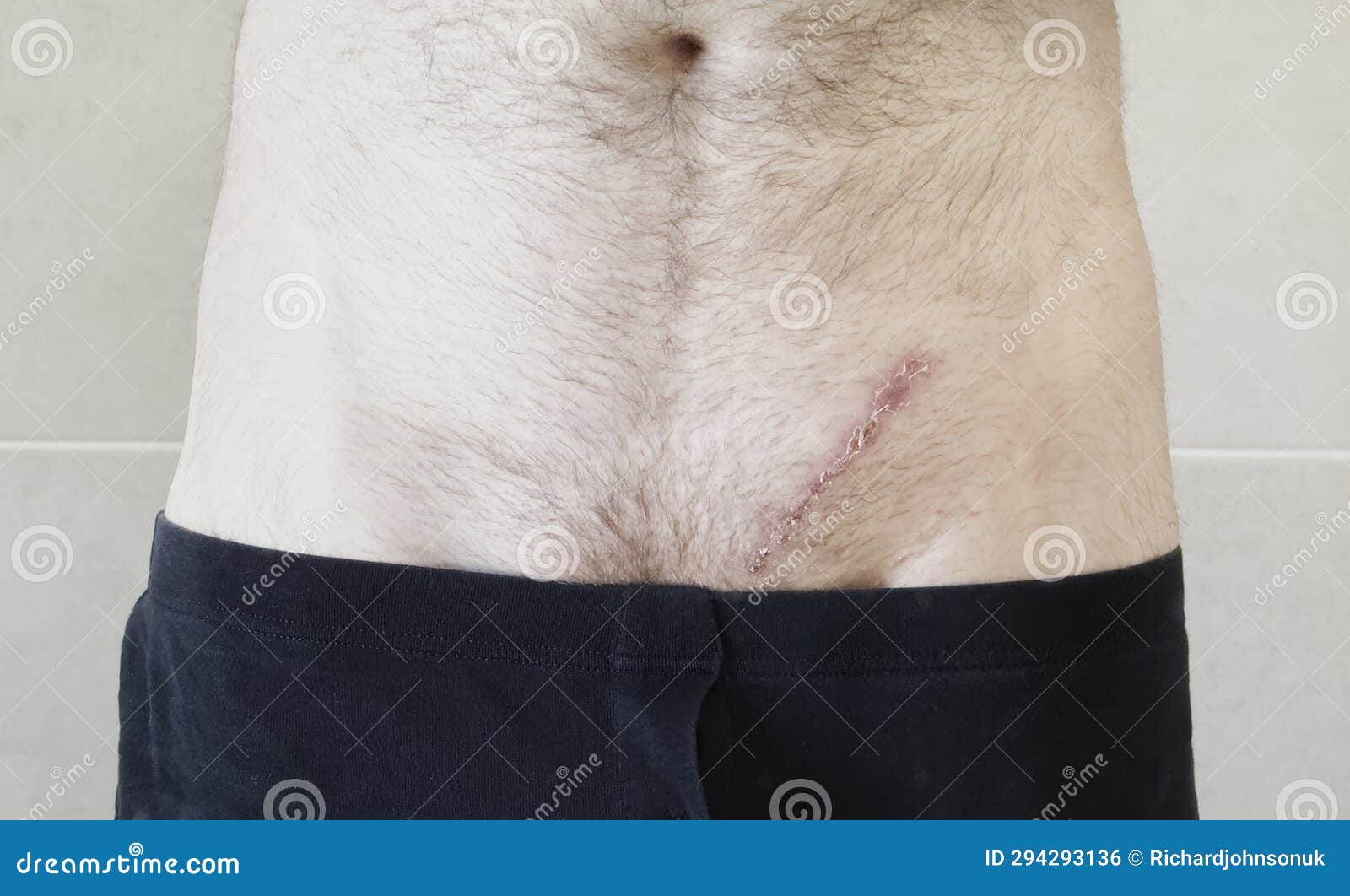 Hernia Scar Post Operation on Man Stock Photo - Image of injury, scab ...