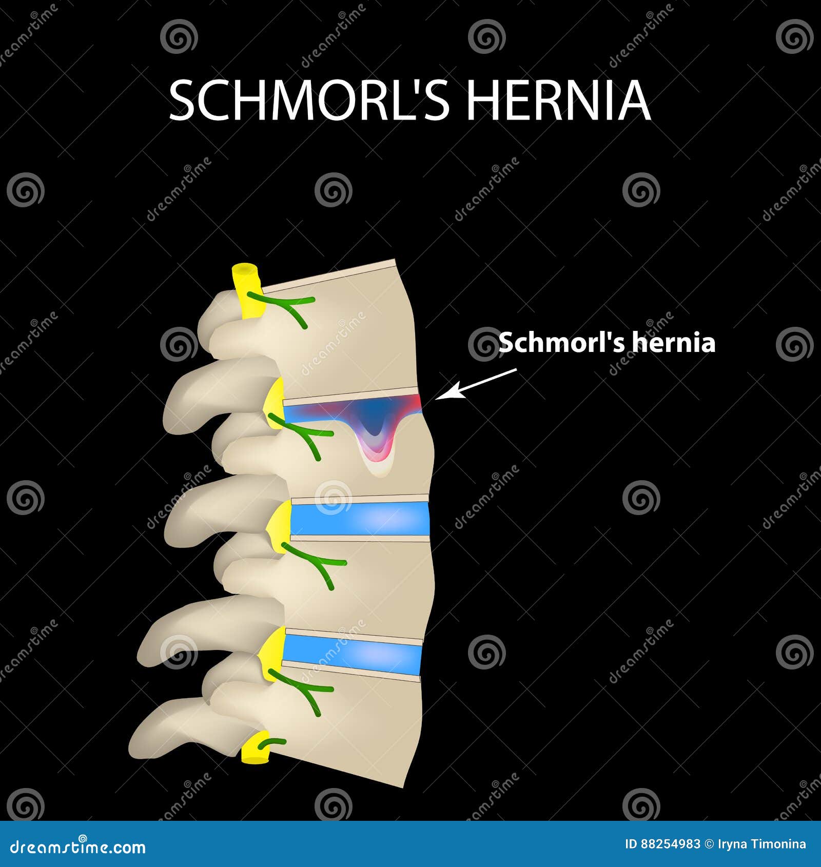 Hernia Schmorl. Intervertebral Disc. Side View. Spine. Infographics ...