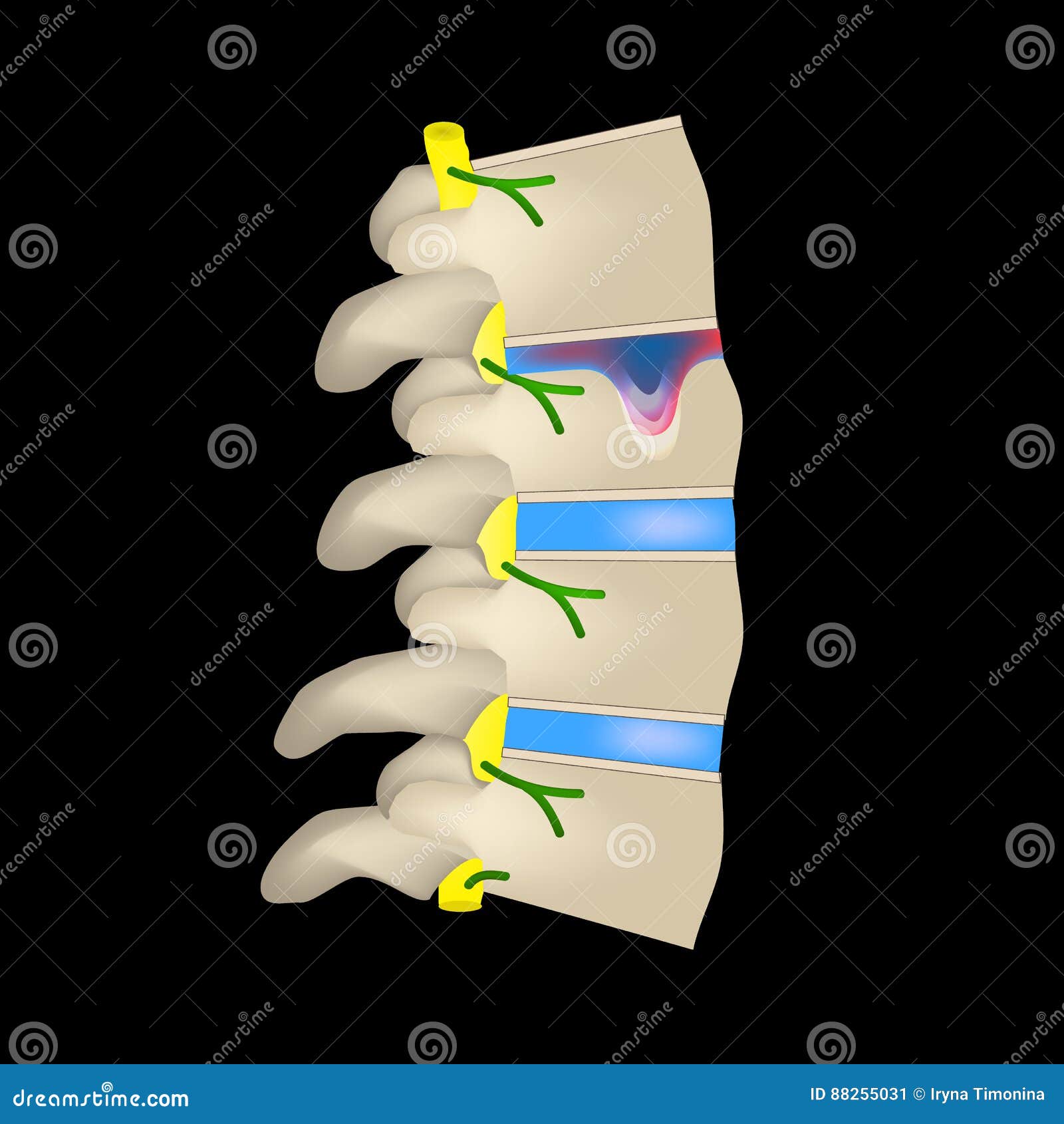 Hernia Schmorl. Intervertebral Disc. Side View. Spine. Infographics ...