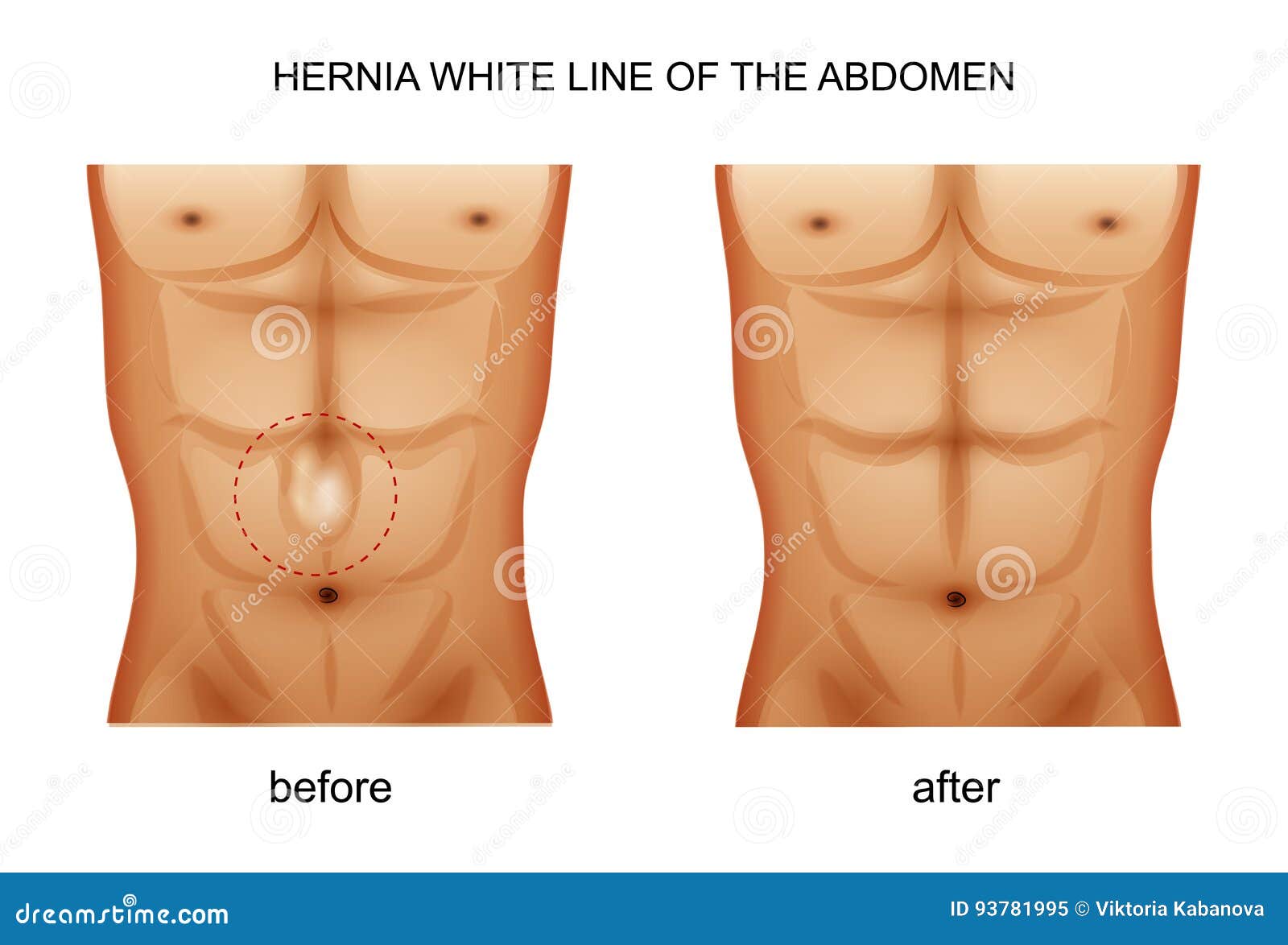 Intestinal Hernia Infographics Vector Illustration On Isolated