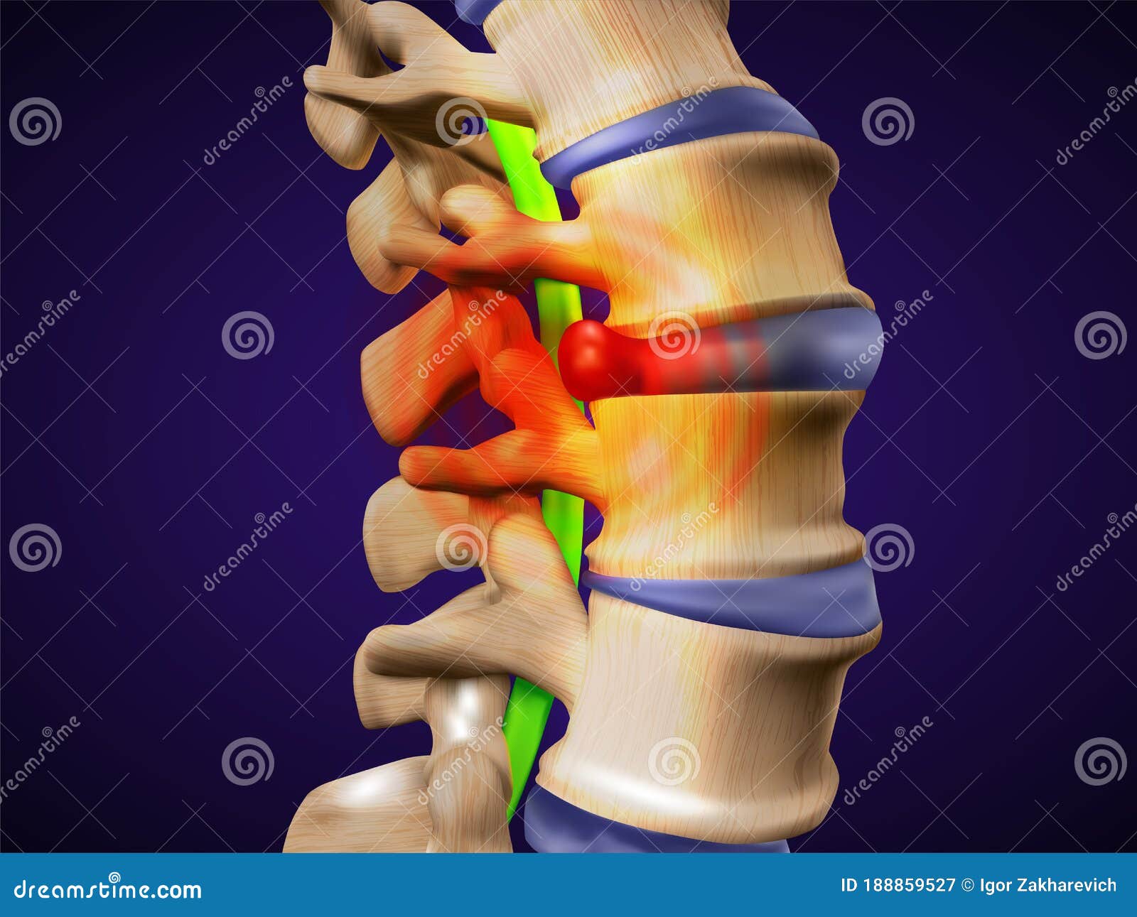 Ruptured Cartoons, Illustrations & Vector Stock Images - 856 Pictures ...