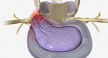 A Herniated Disc is a Condition Characterized by Structural Changes To ...