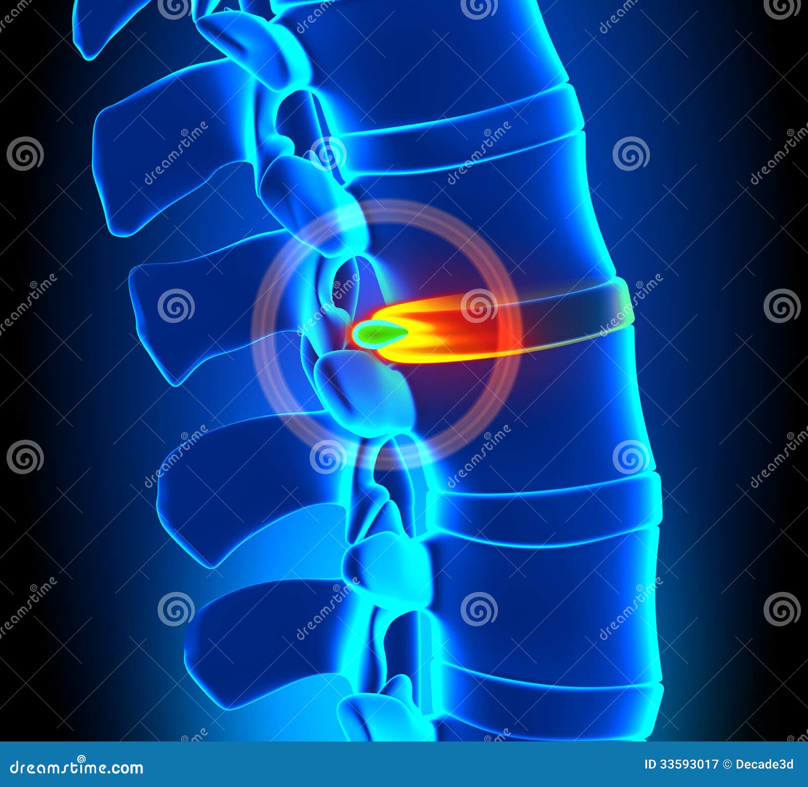 Herniated Disc Degeneration - Spine Problem Stock Illustration ...