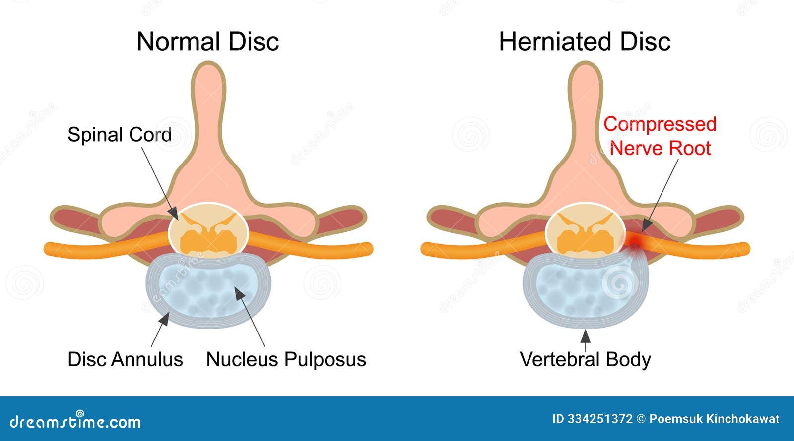 Herniated Disc Is Also Known As A Slipped Cartoon Vector ...