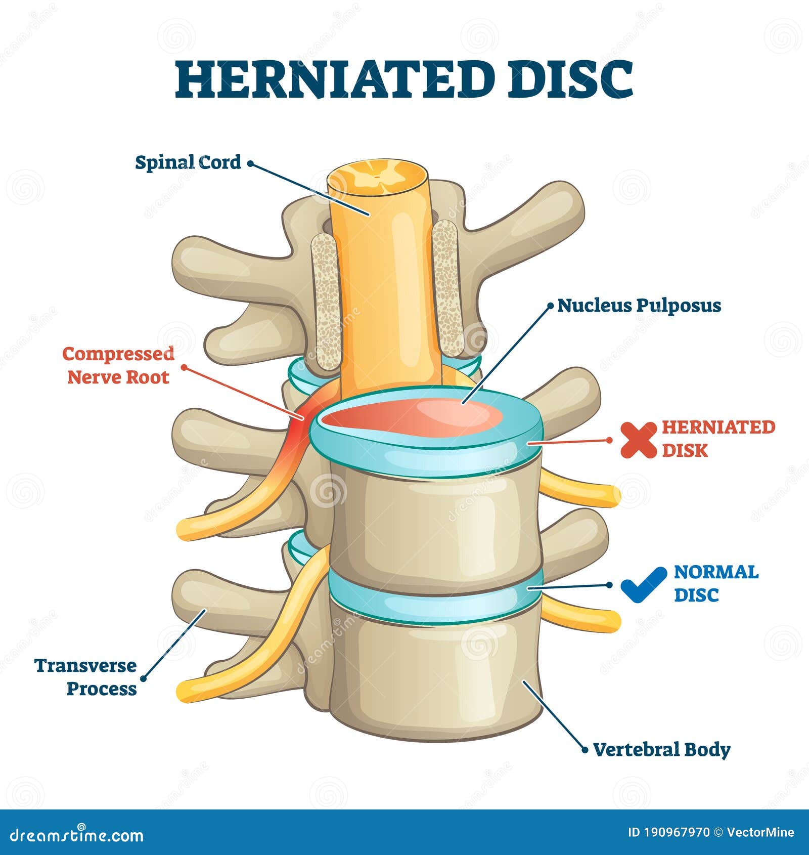 Herniated Disc Injury 3D Side View on Spine Bone Skeleton Vector ...