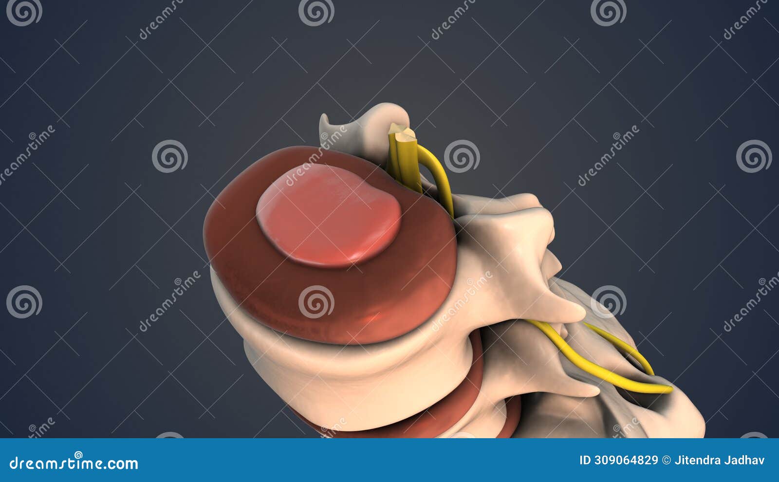 Herniated Disc of the Lumbar Spine Stock Illustration - Illustration of ...