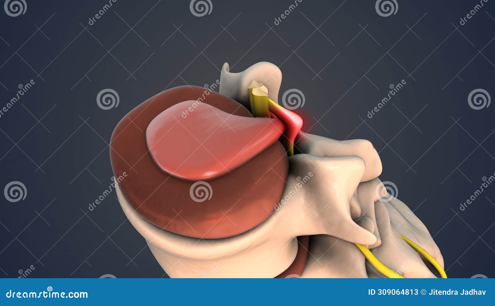 Herniated Disc of the Lumbar Spine Stock Illustration - Illustration of ...
