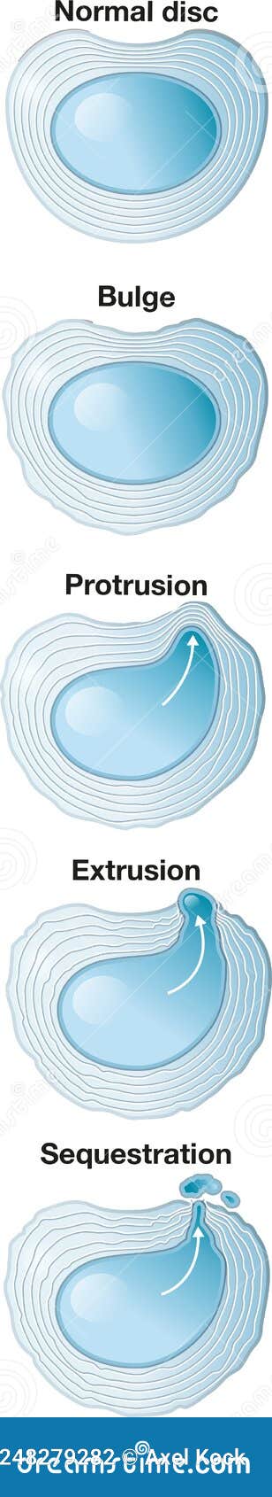 Protusion Stock Illustrations – 3 Protusion Stock Illustrations ...