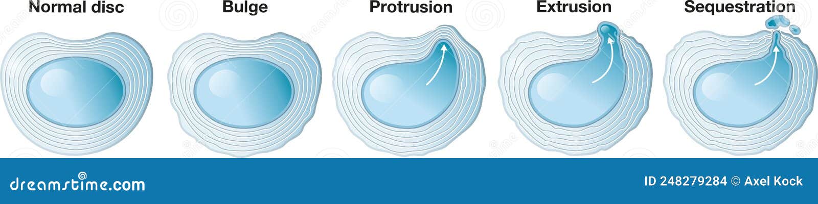 Herniated Disc Schema. Normal Disc. Bulge. Protusion. Extrusion ...