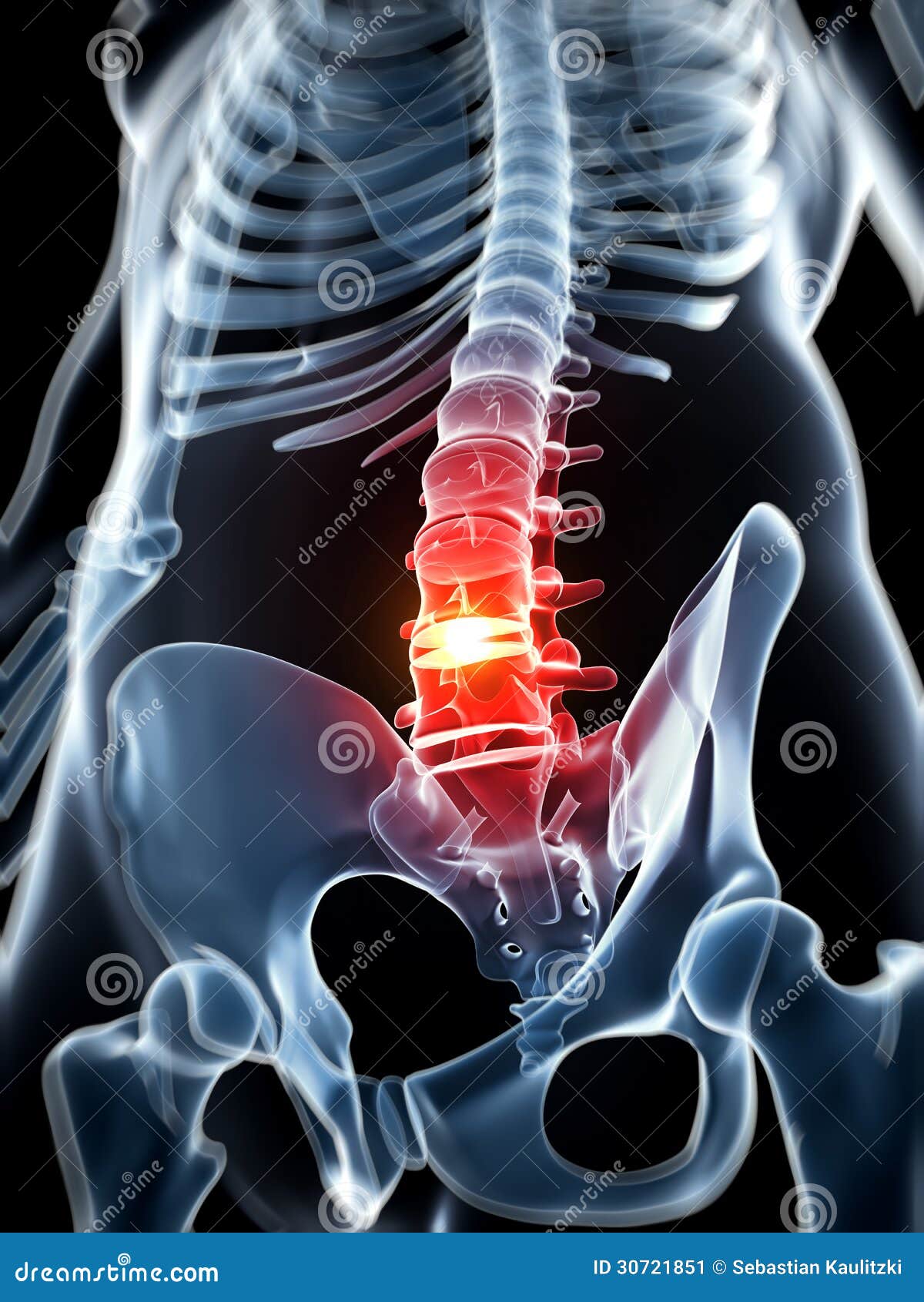 Herniated disk stock illustration. Illustration of nucleus - 30721851