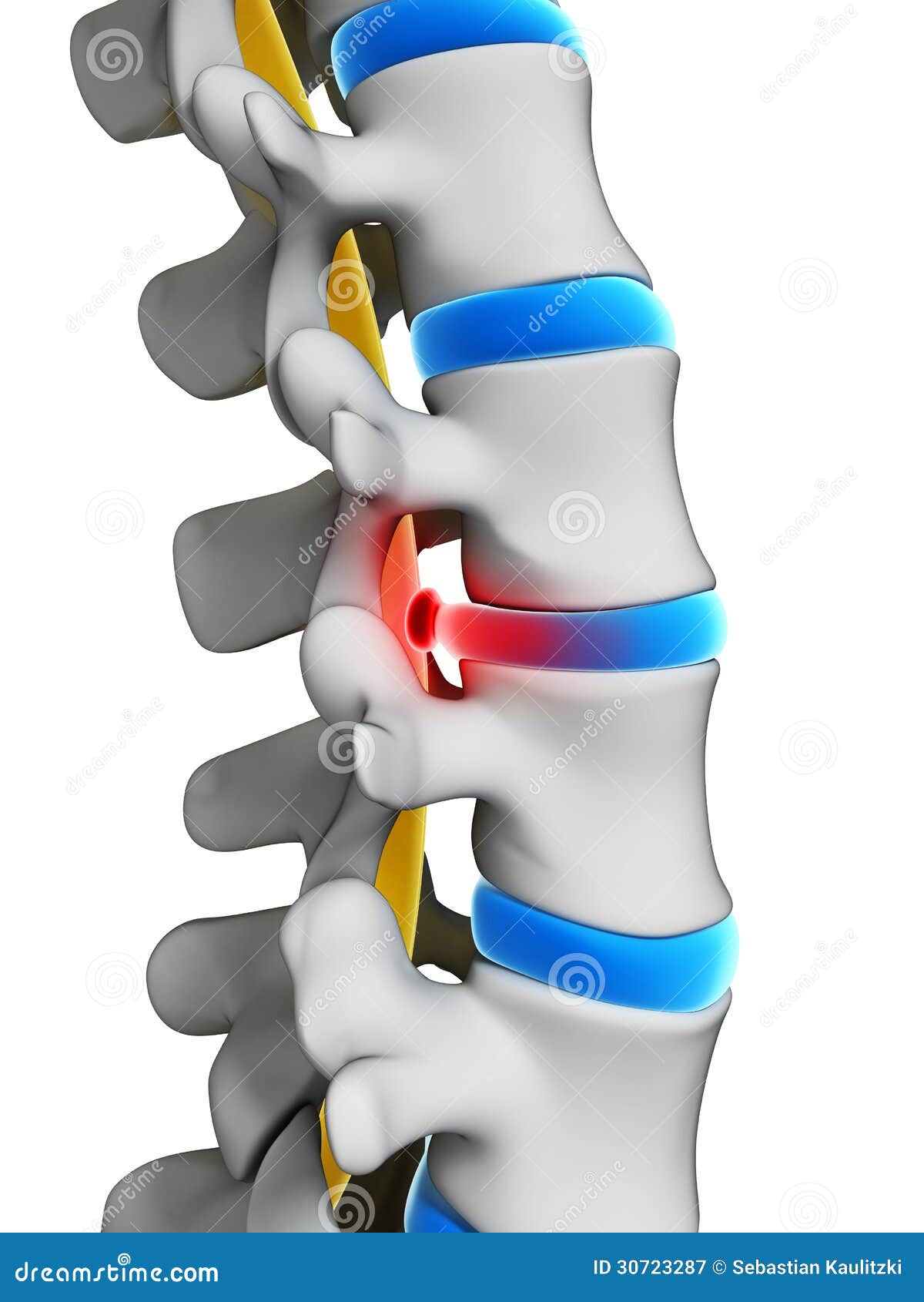 Painful Herniated Disk, Medically 3D Illustration On Black Background ...