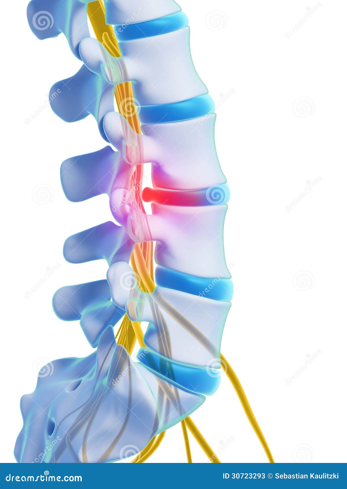 Painful Herniated Disk, Medically 3D Illustration On Black Background ...