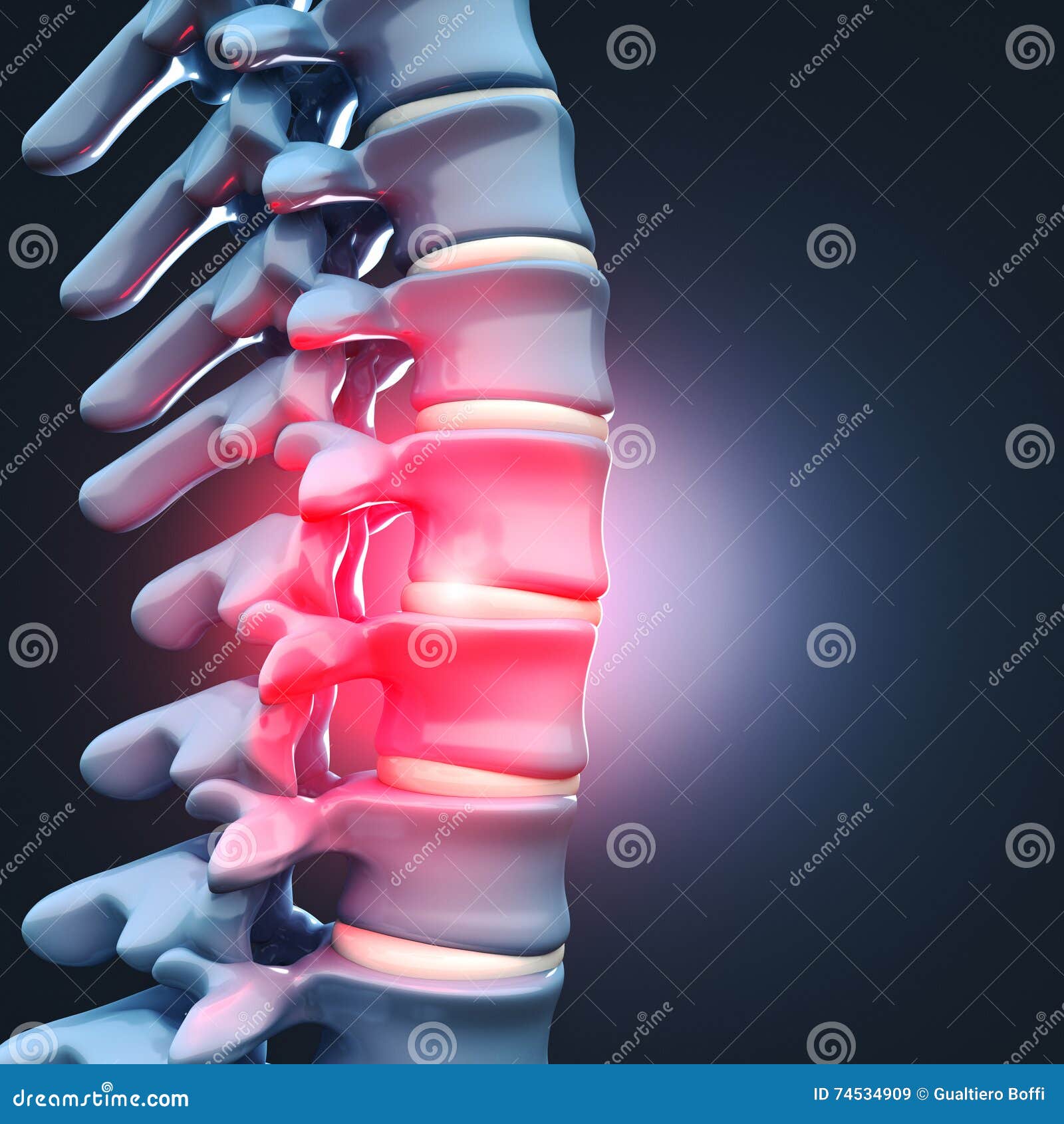 Herniated Disk Human Spinal Stock Illustration - Illustration of ...