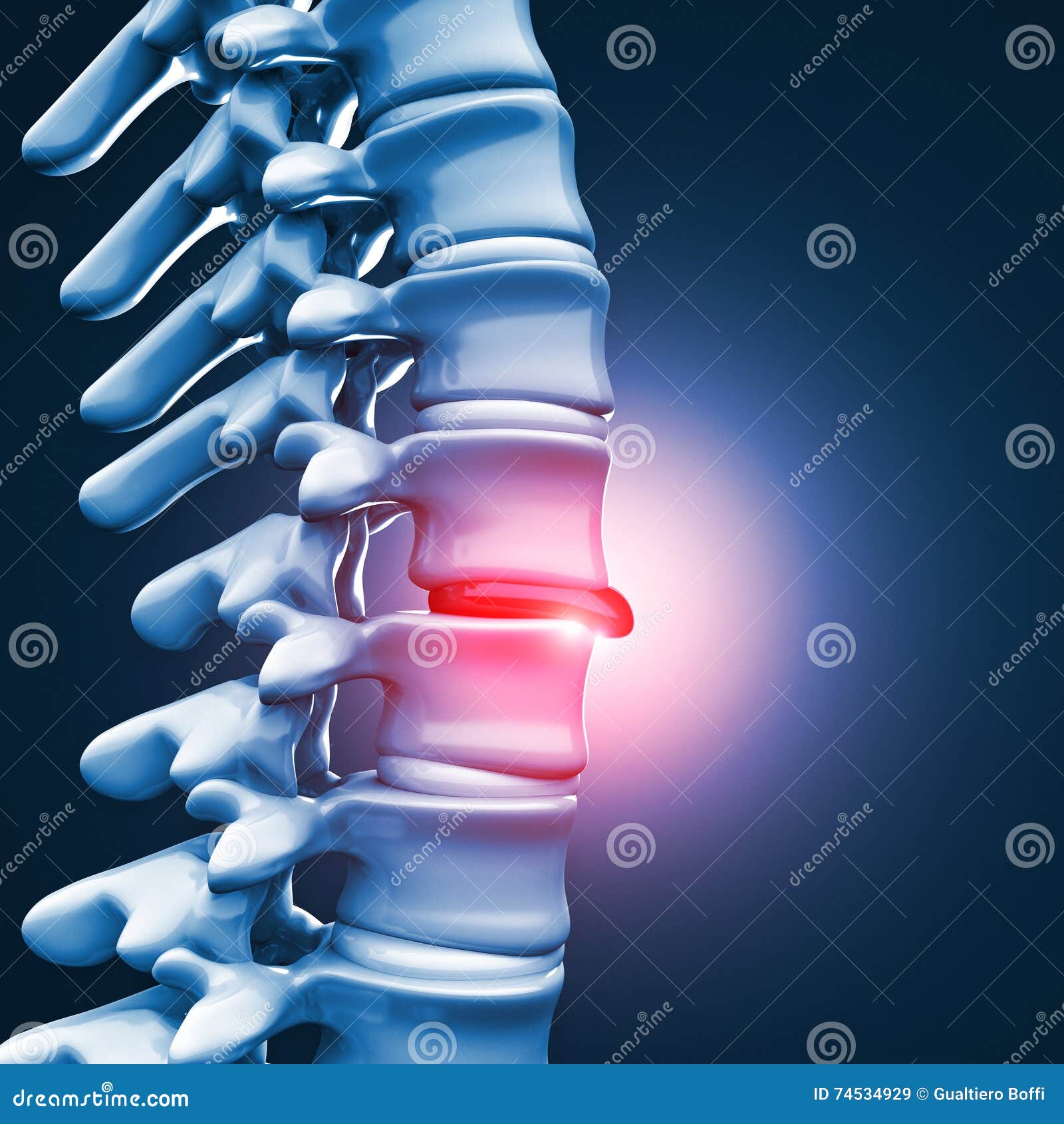 Herniated Disk Human Spinal Stock Illustration - Illustration of detail ...