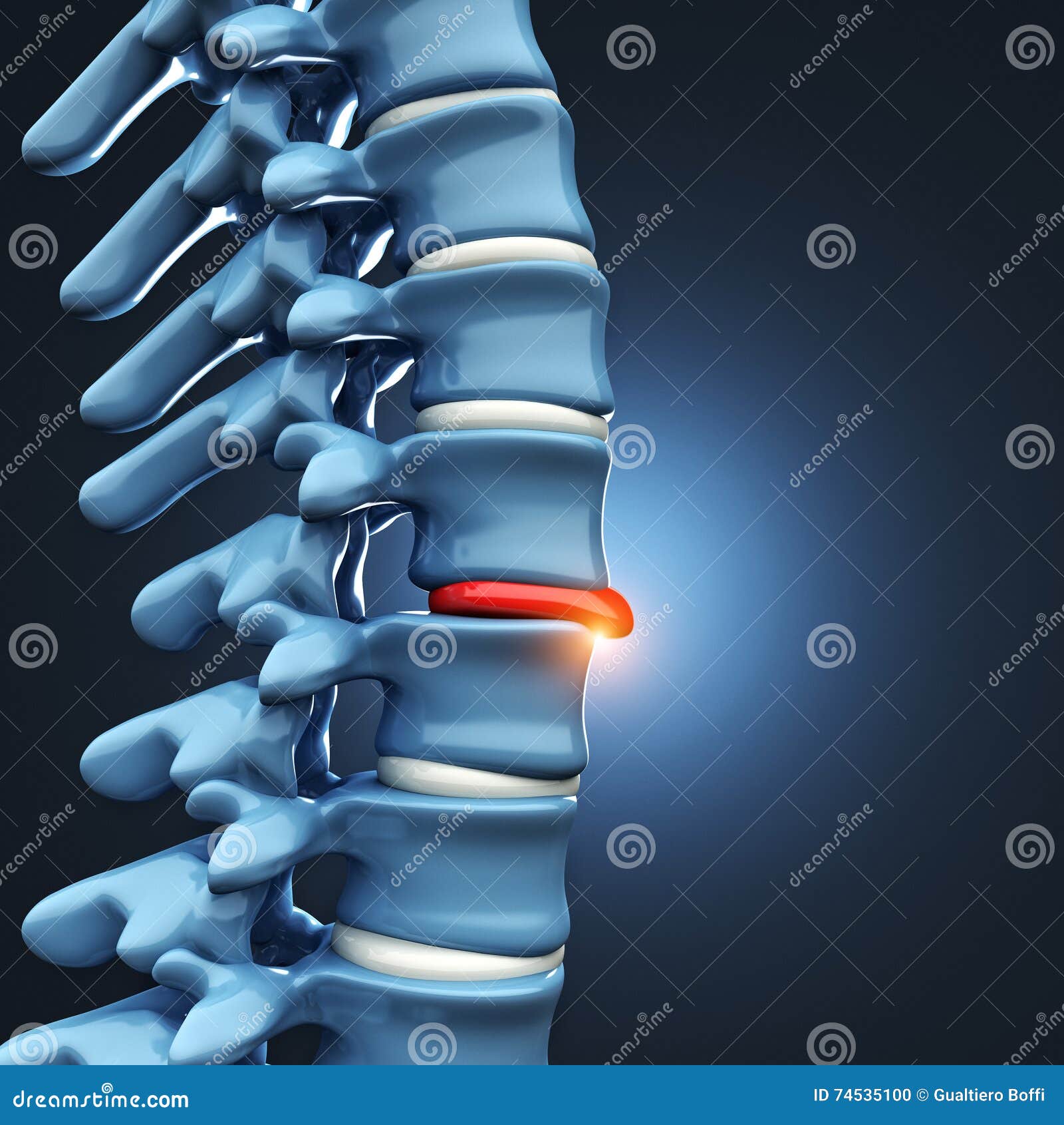 Herniated Disk Human Spinal Stock Illustration - Illustration of ...