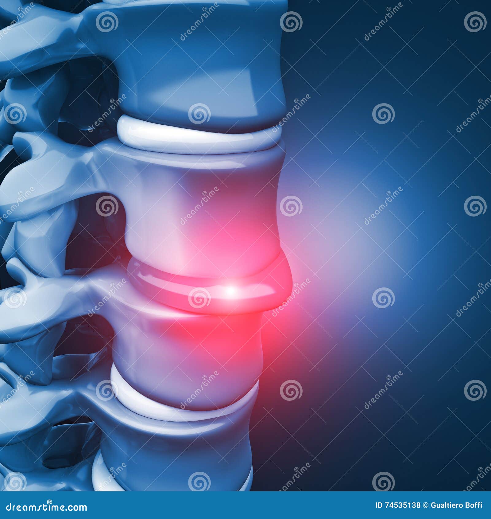 Herniated Disk Human Spinal Stock Illustration - Illustration of ...
